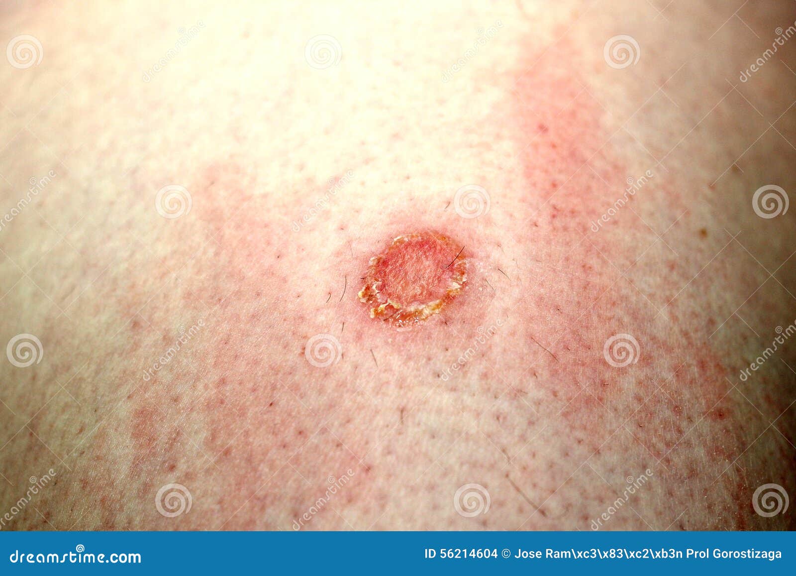 Wound in the Skin Makes Pain Stock Photo - Image of blood, health: 56214604