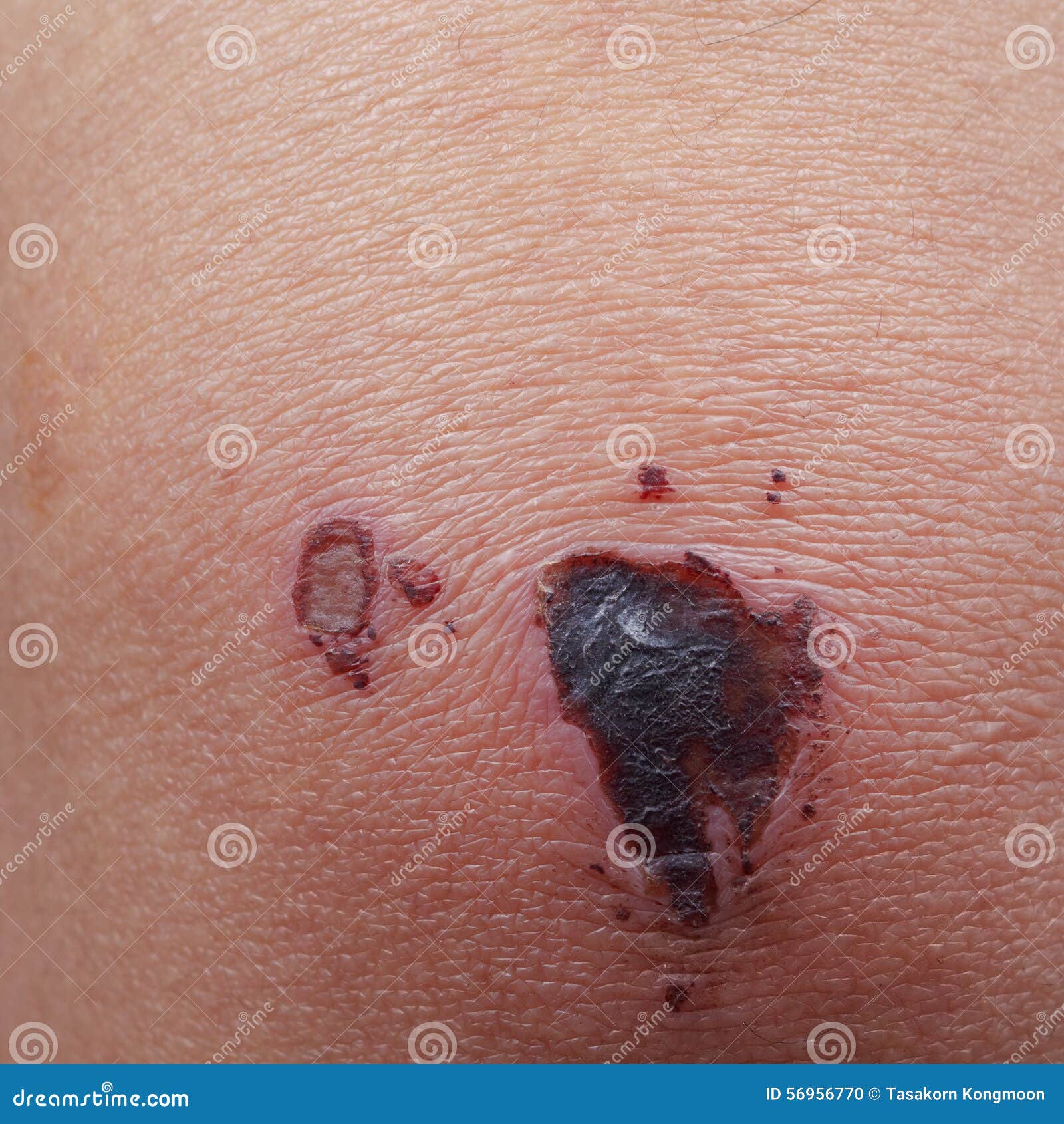 Wound on skin for pattern stock photo. Image of medicine - 56956770