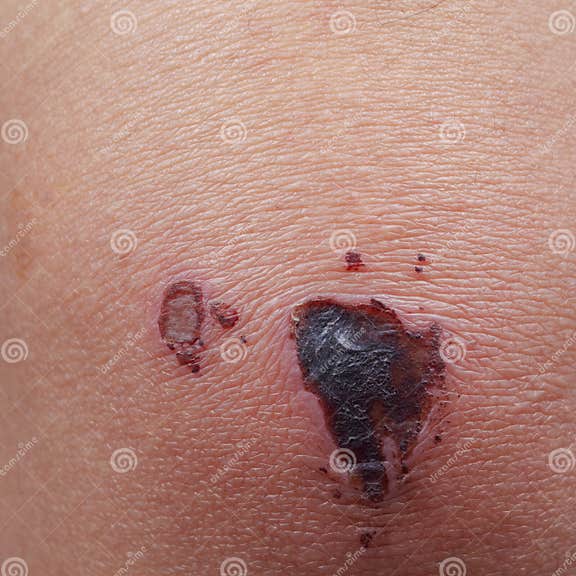 Wound on skin for pattern stock photo. Image of medicine - 56956770