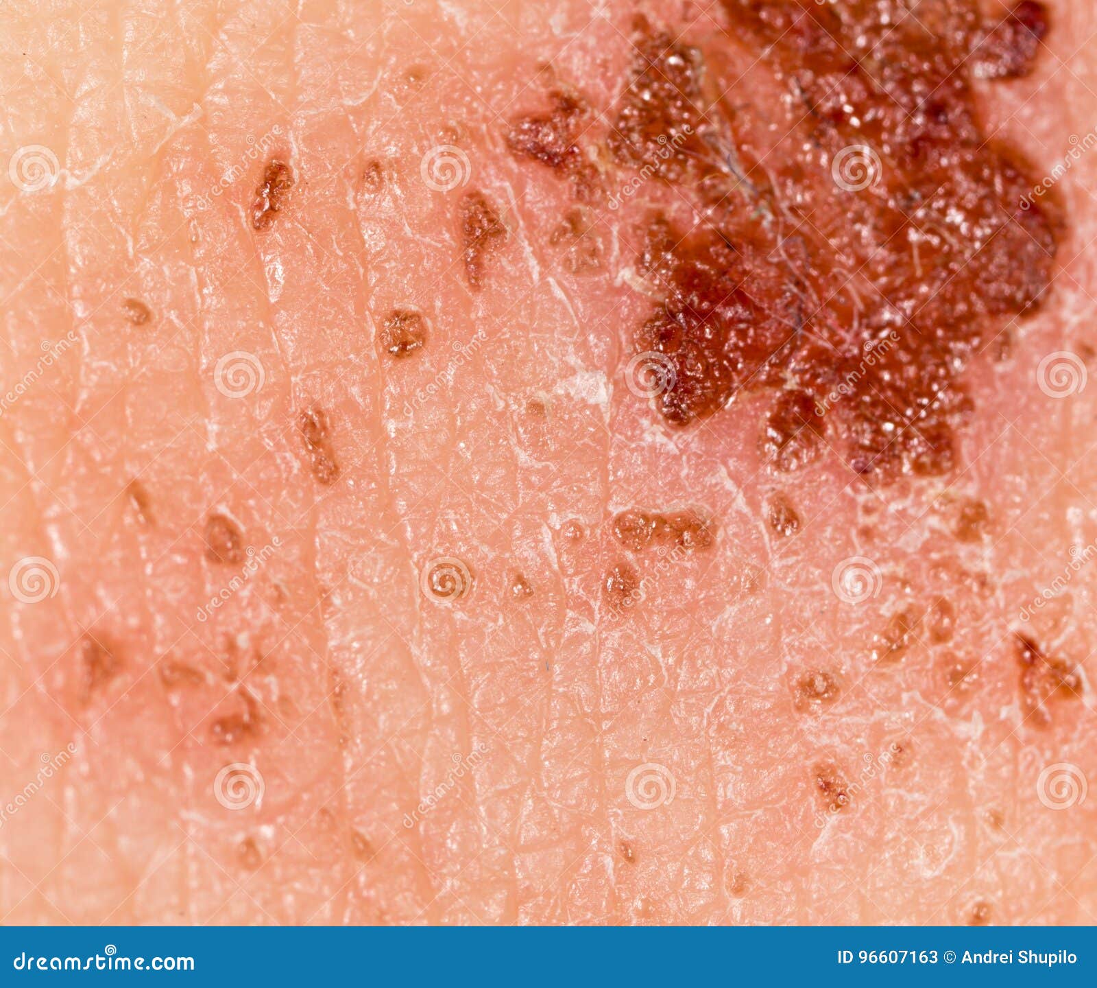 Wound on the Skin of a Person Stock Image - Image of skin, person: 96607163