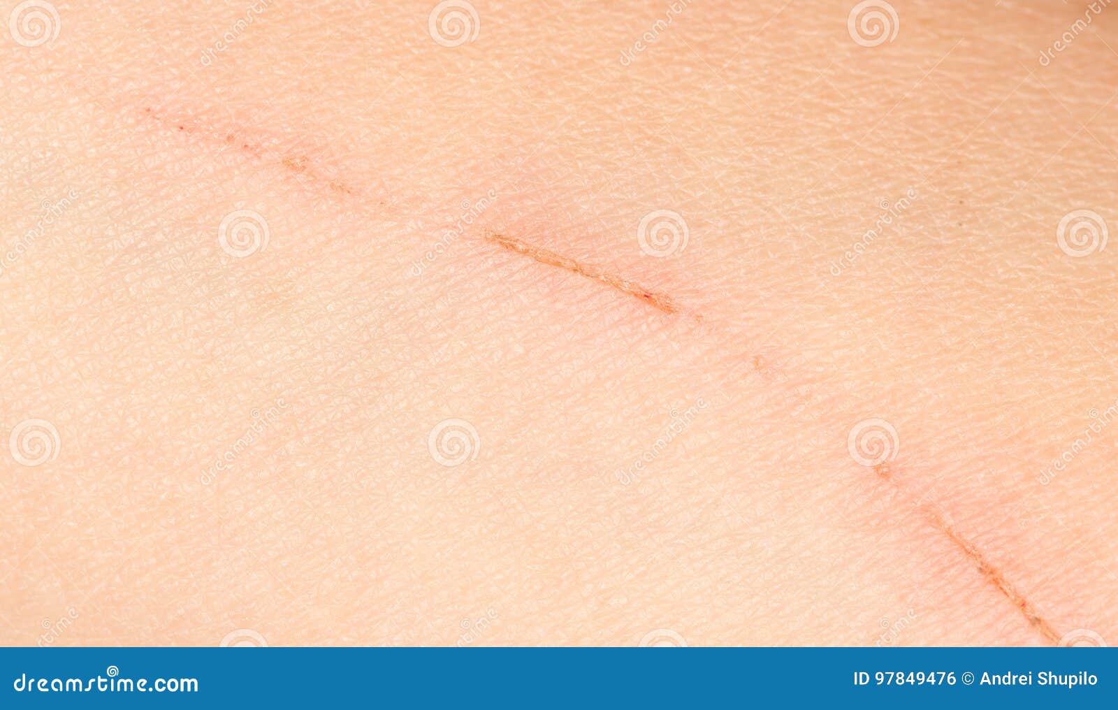 A wound on the skin stock photo. Image of medicine, pain - 97849476