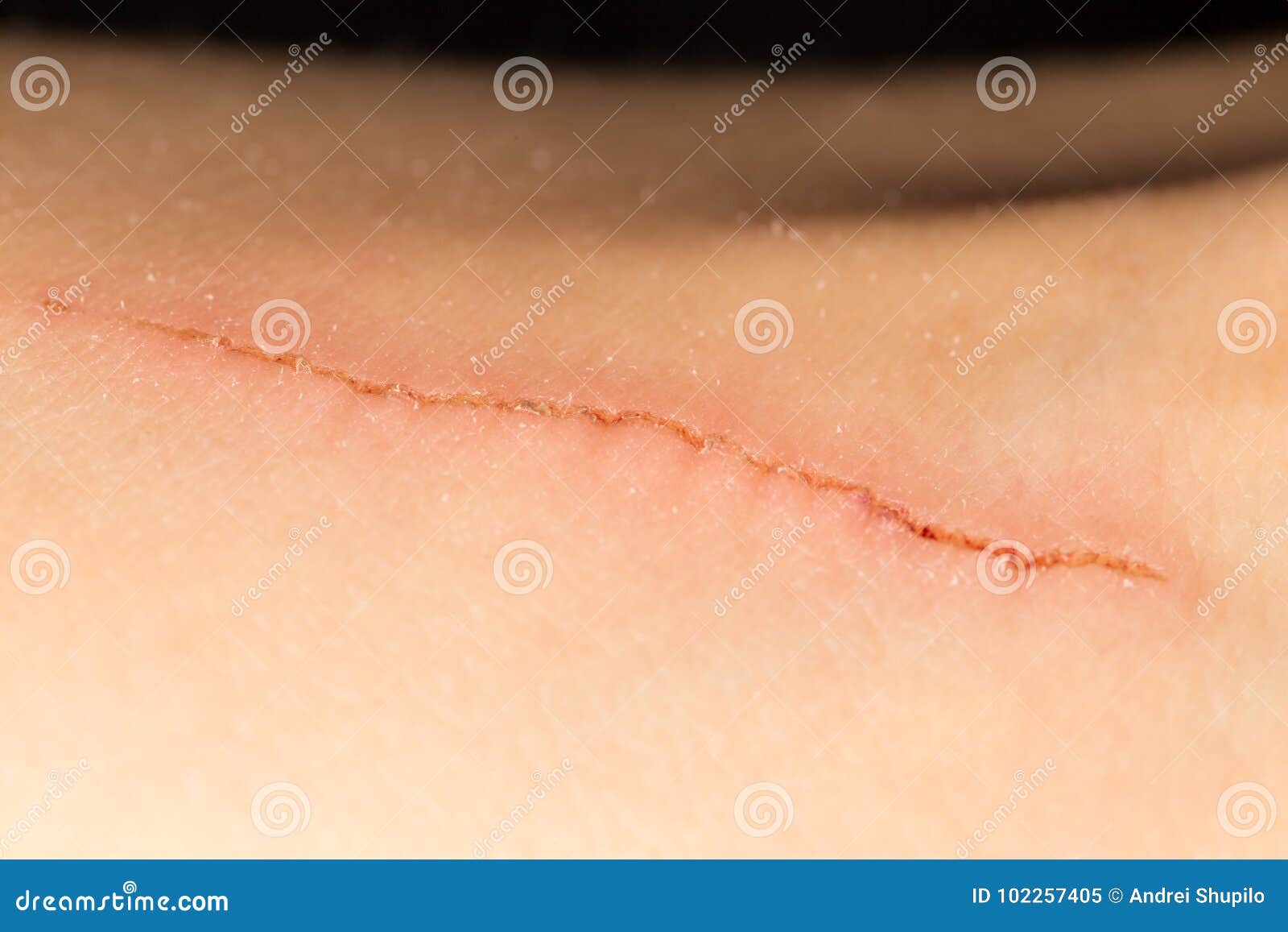 Wound On Skin. Royalty-Free Stock Photo | CartoonDealer.com #97253007