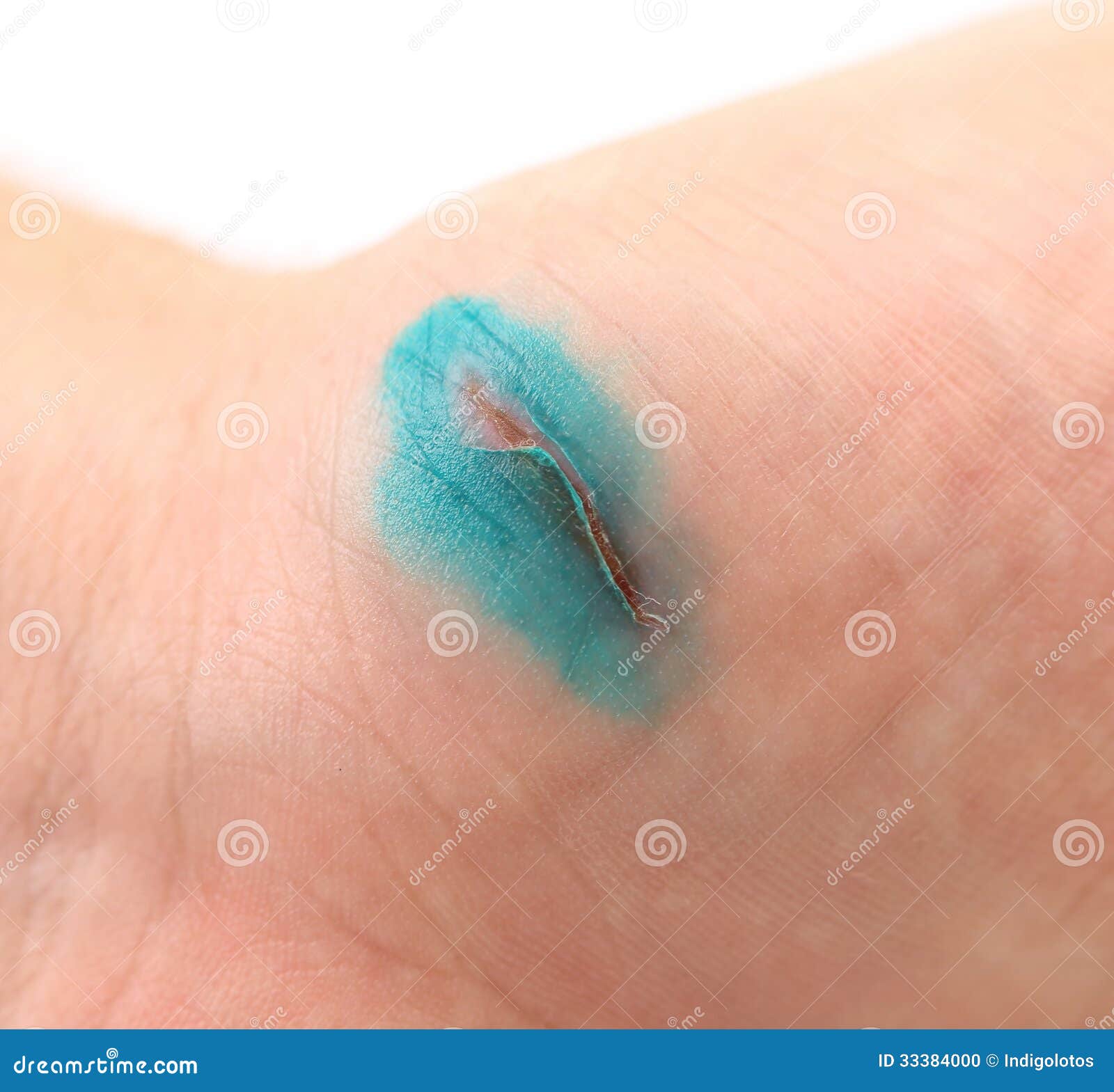 Wound On The Skin Worked Of Brilliant Green. Stock Photo - Image: 33384000