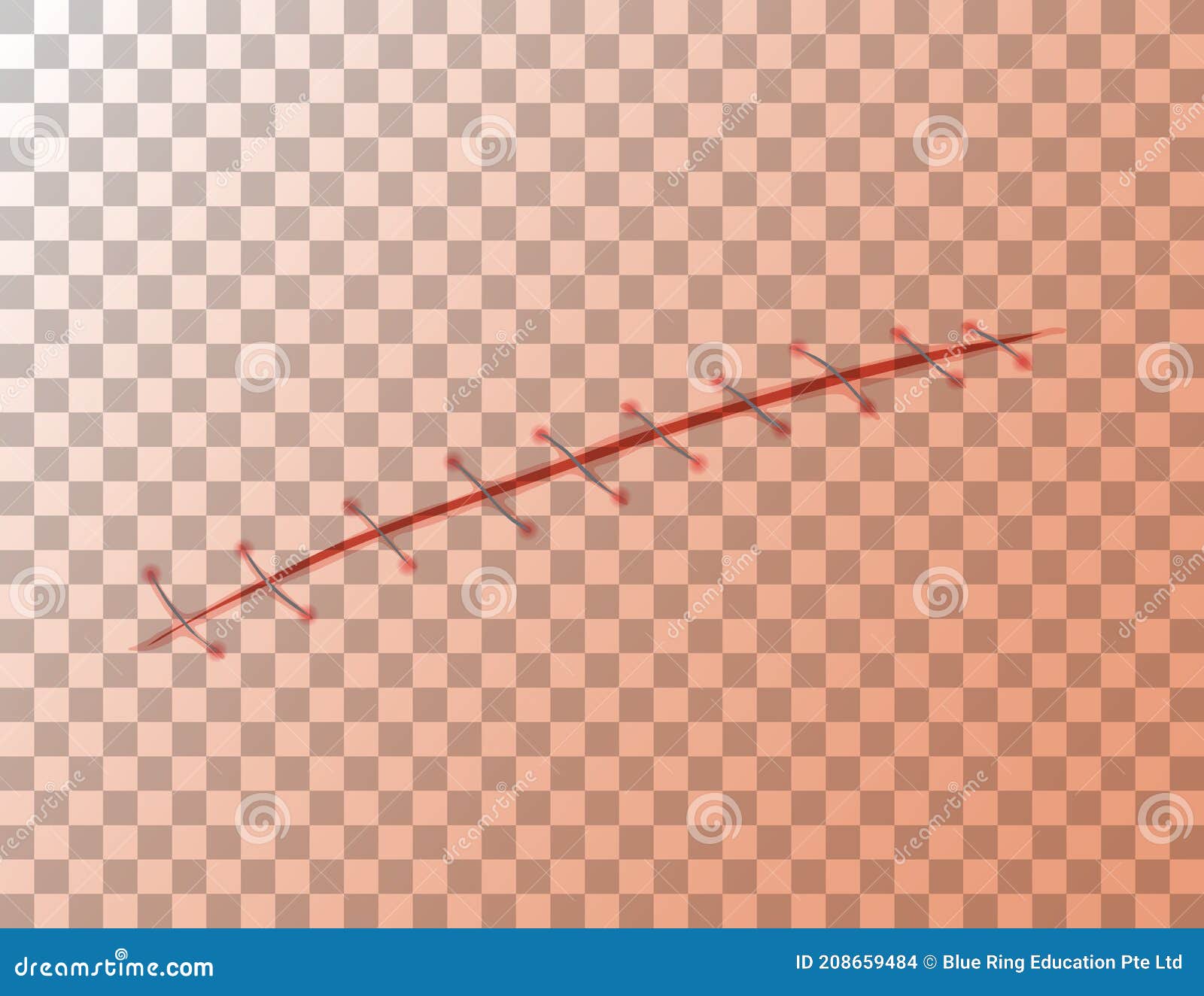 Wound Suturing on Transparent Background Stock Vector - Illustration of ...