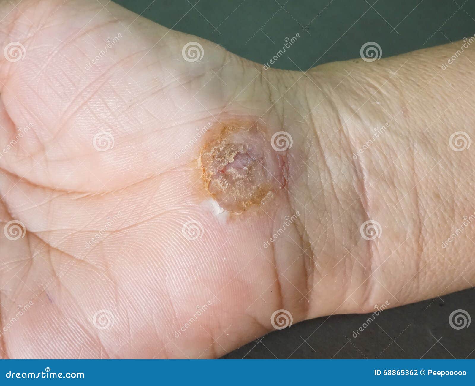 Wound on woman hand stock photo. Image of body, bandage - 68865362