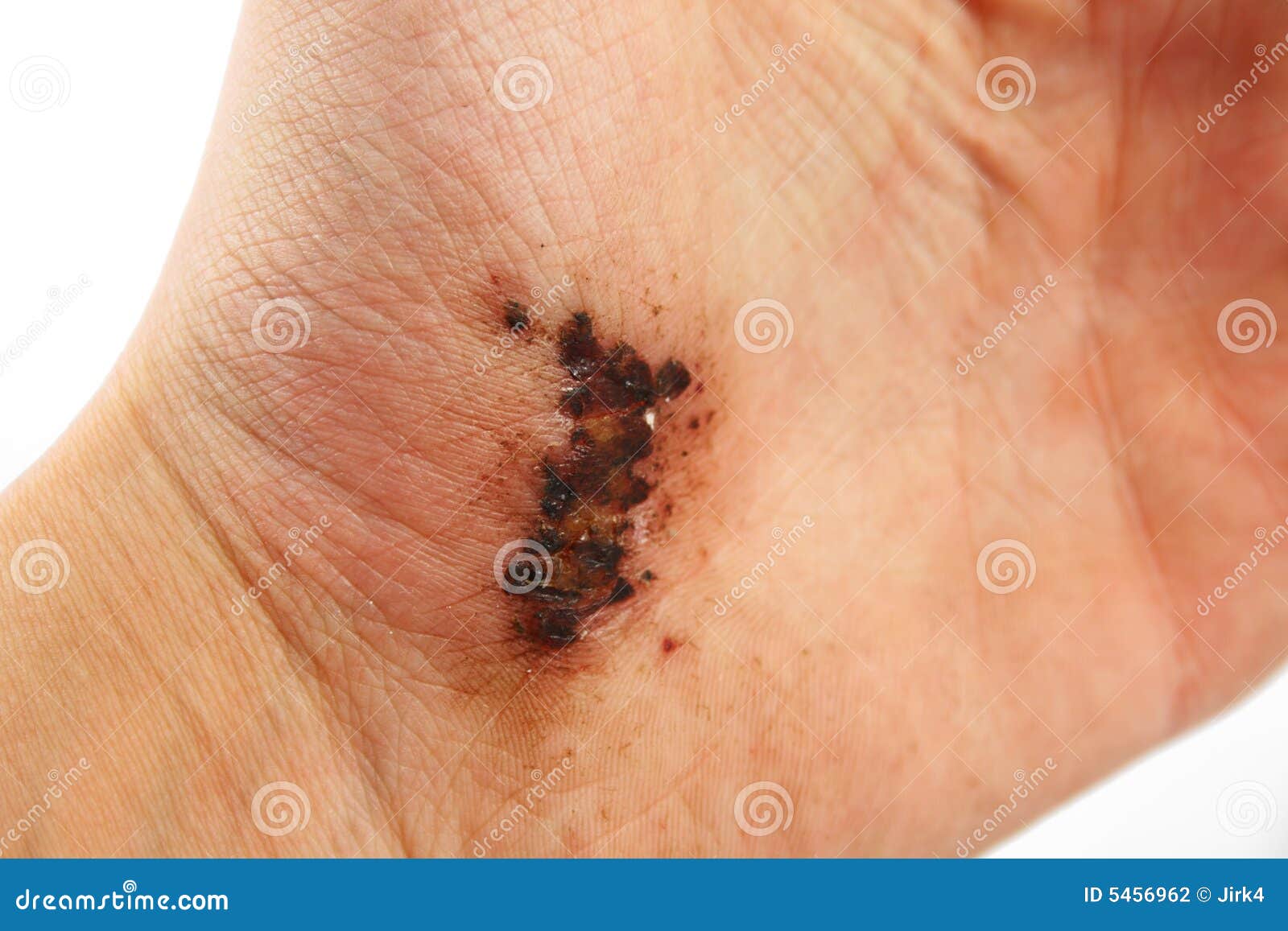 Wounded hand stock photo. Image of wound, closeup, help - 5456962