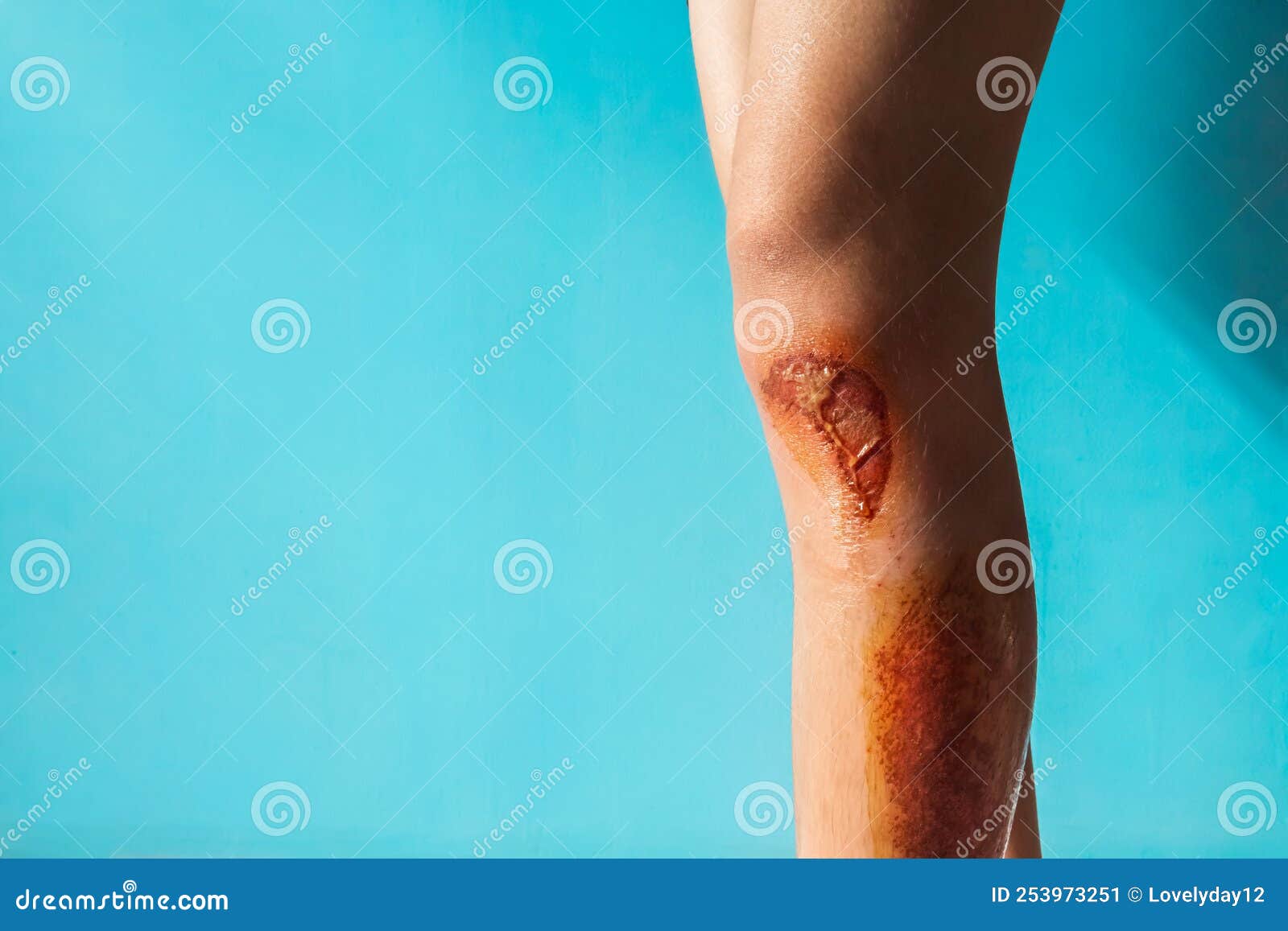 Wounded Leg on Blue Background Stock Image - Image of damage, people ...