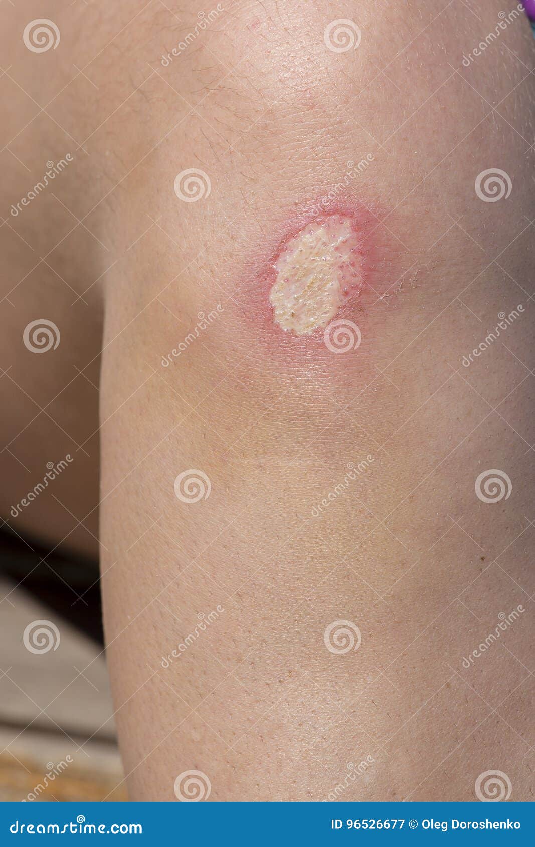 Wounded leg, close up stock image. Image of knee, hurt - 96526677