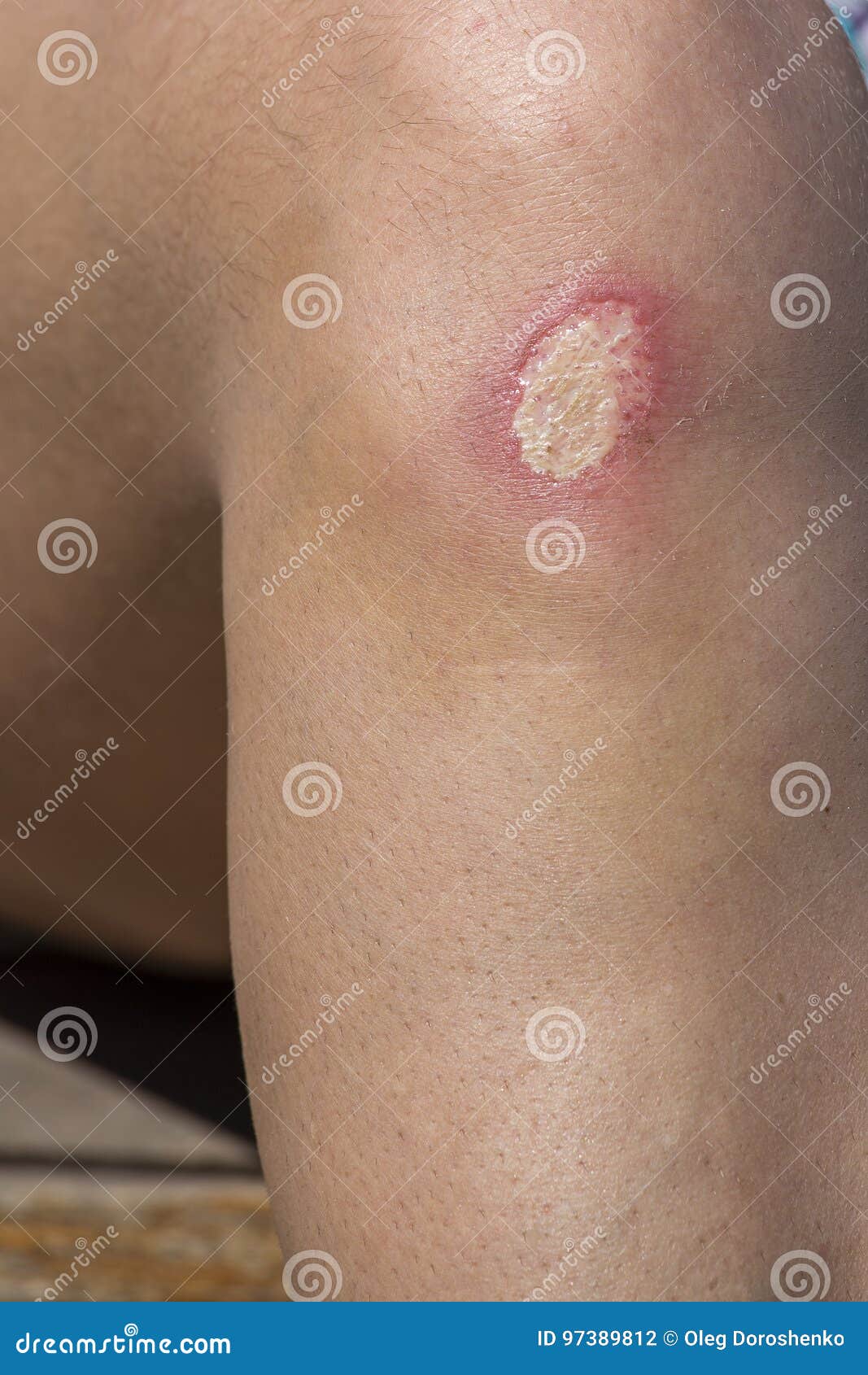 Wounded leg, close up stock photo. Image of help, knee - 97389812