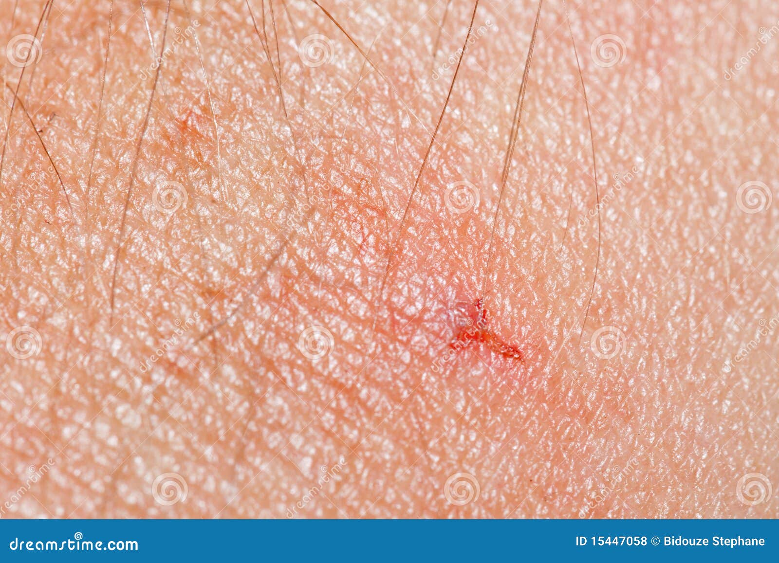 Wounded male skin stock photo. Image of injury, biology - 15447058