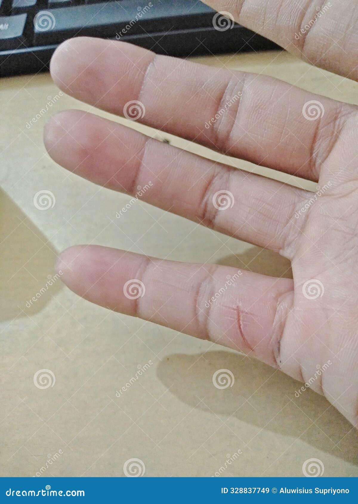 Wounds that Can Be Caused by Sharp Objects Stock Image - Image of palm ...