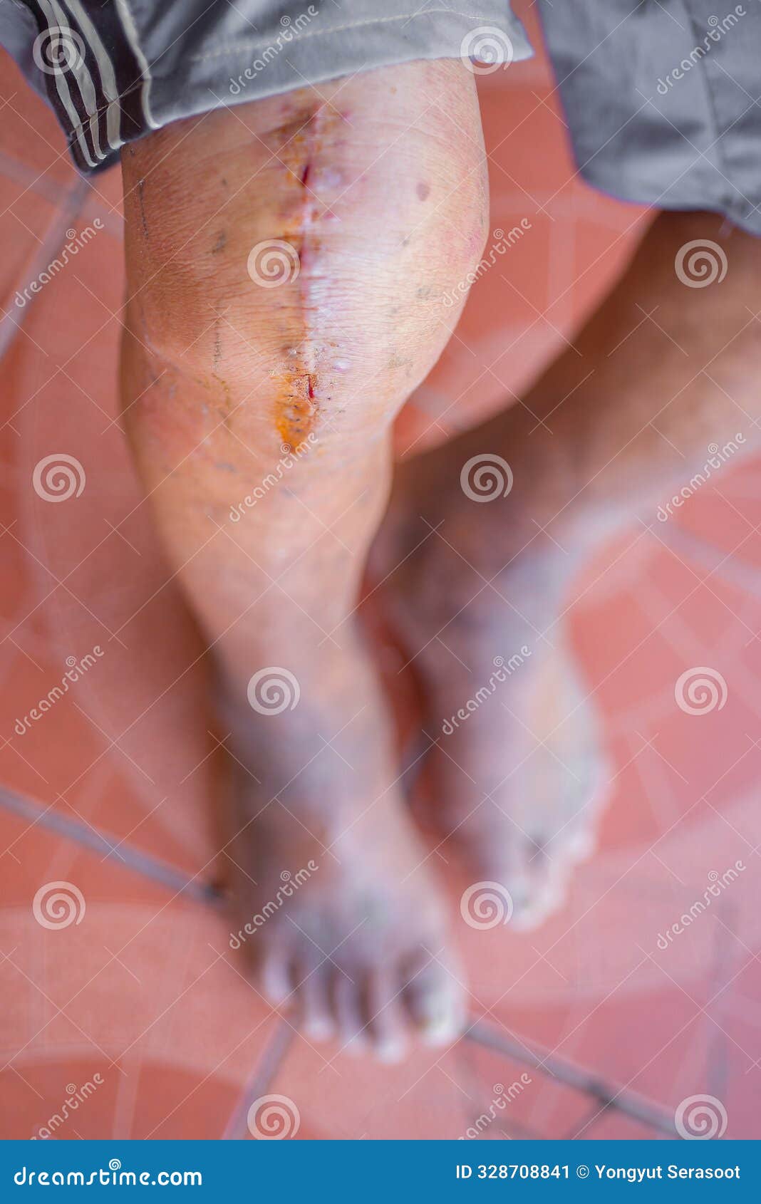 Wounds from the Knee Surgery of the Elderly Stock Image - Image of ...