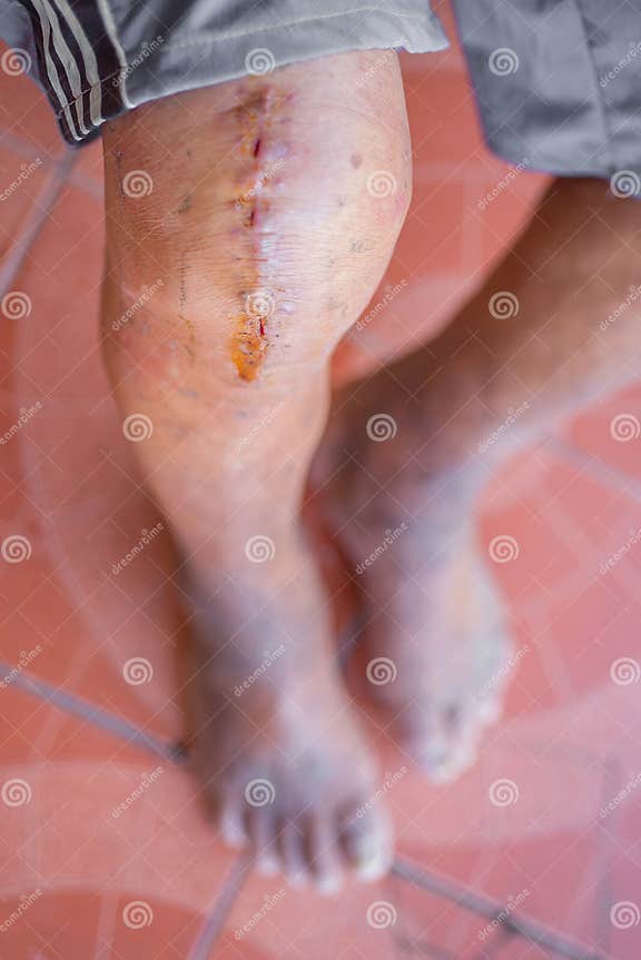 Wounds from the Knee Surgery of the Elderly Stock Image - Image of ...