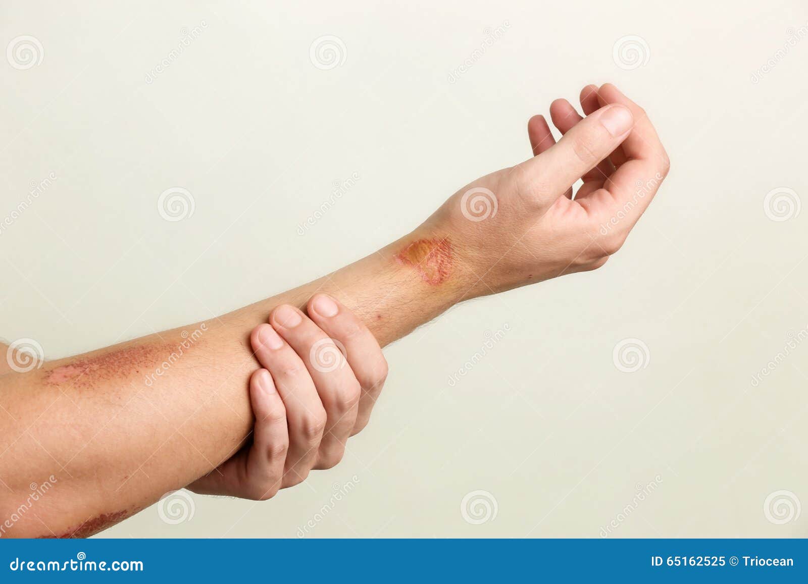 Wounds on man s arm stock image. Image of backdrop, health - 65162525