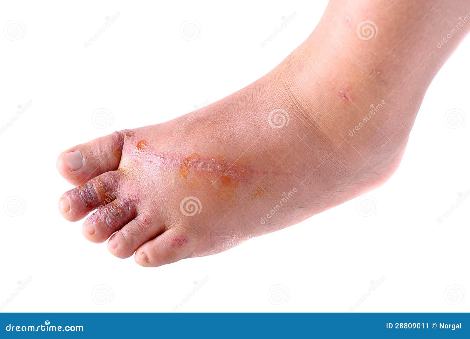 Wounds on women foot stock image. Image of illness, plasma - 28809011