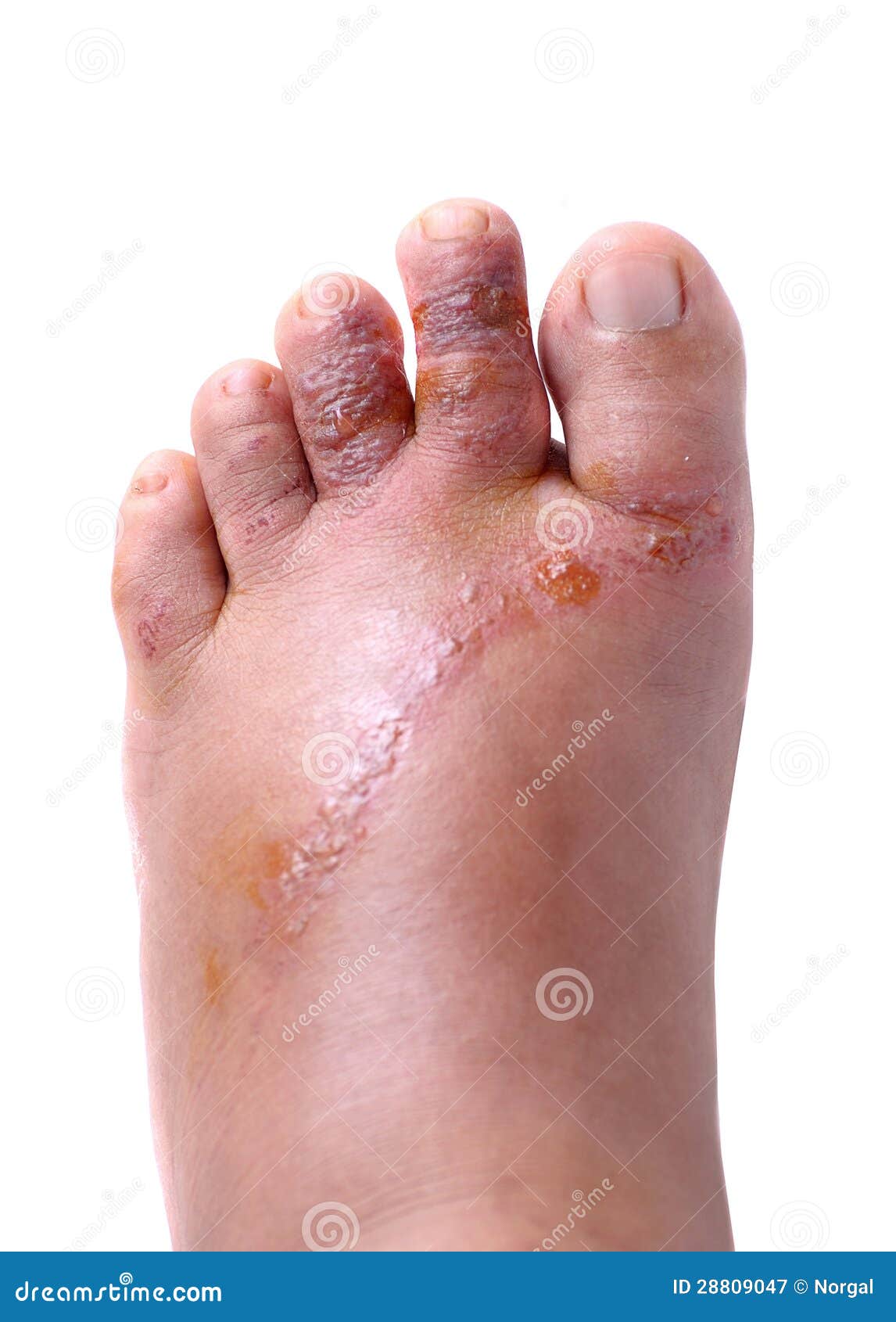 Closeup Of Wounds Or Injury On Indian Man Leg, Feet Royalty-Free Stock ...