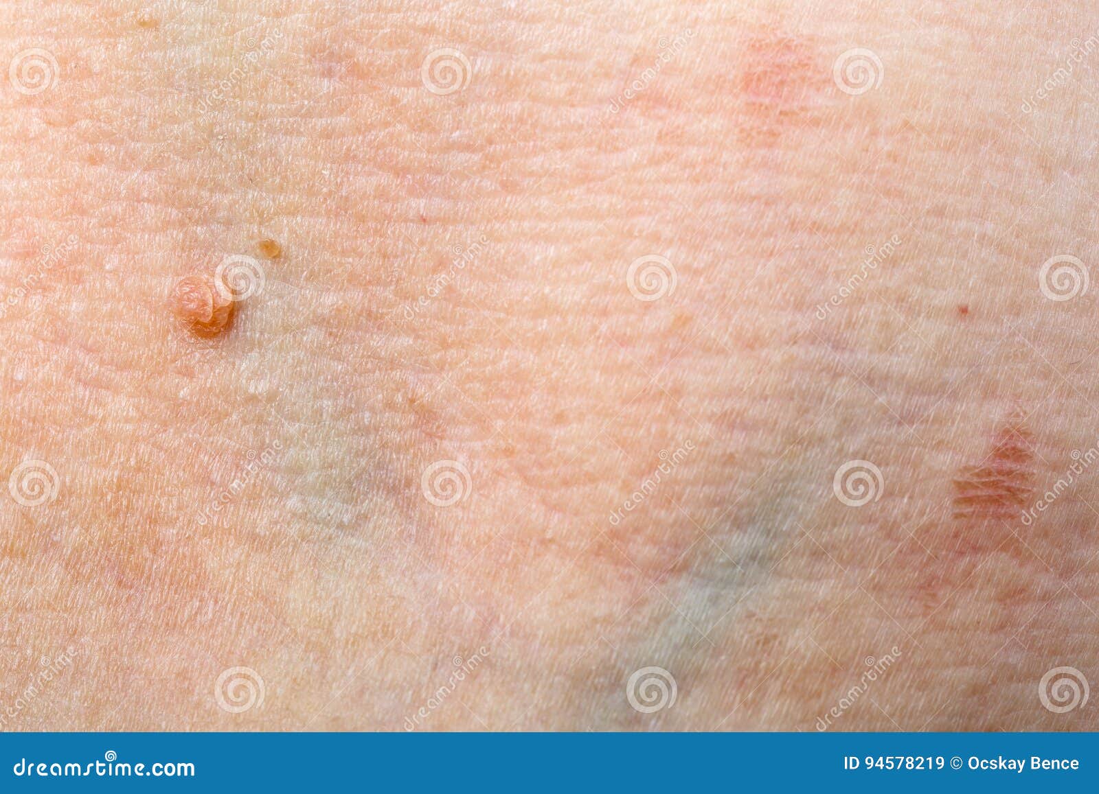 Wrat op menselijke huid stock afbeelding. Image of gemeenschappelijk ...