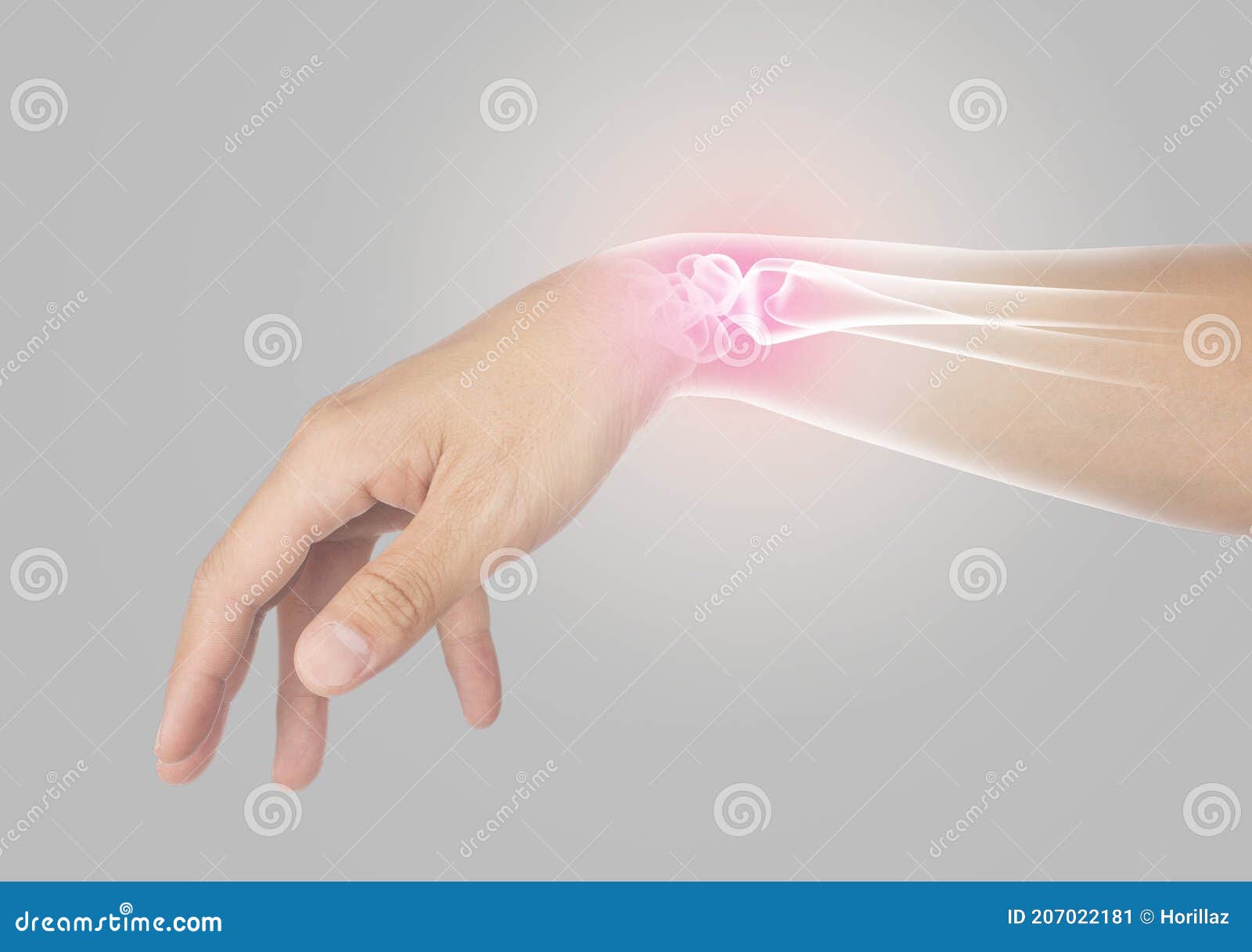 Wrist Bones Injury Gray Background Stock Image - Image of disease ...