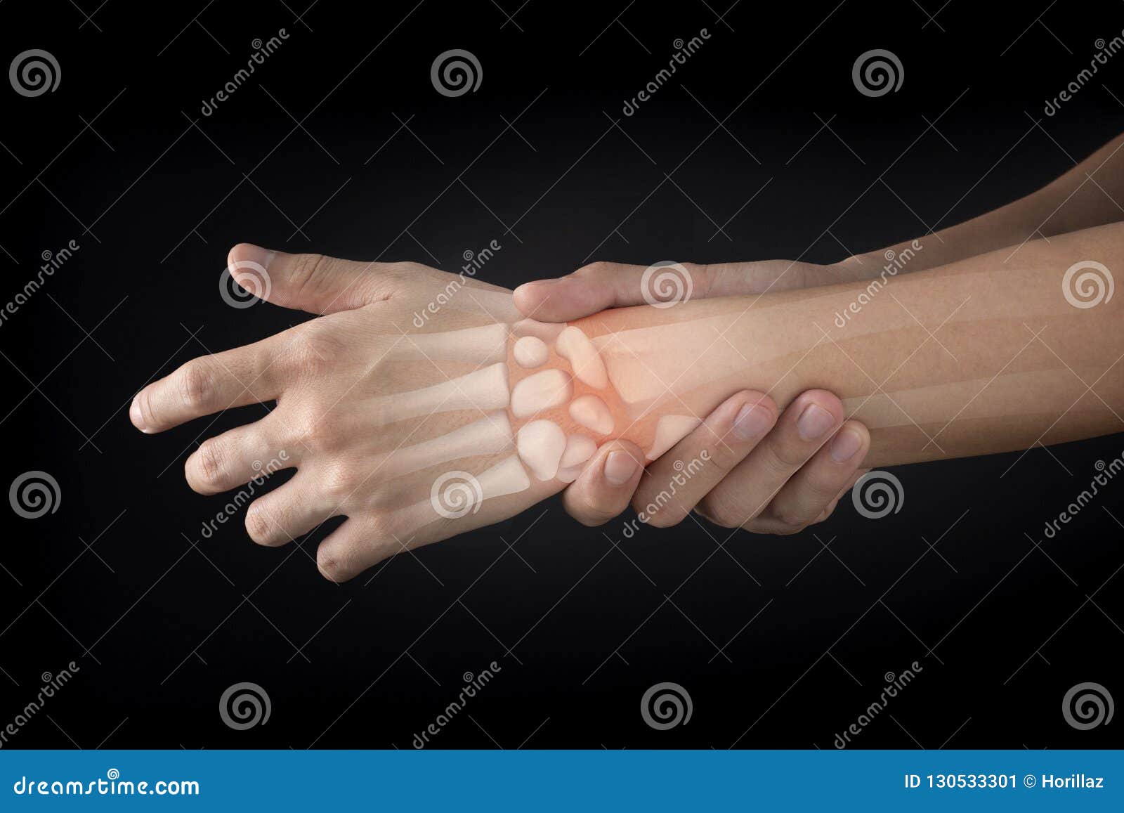 Wrist bones injury stock image. Image of phalanges, ache - 130533301