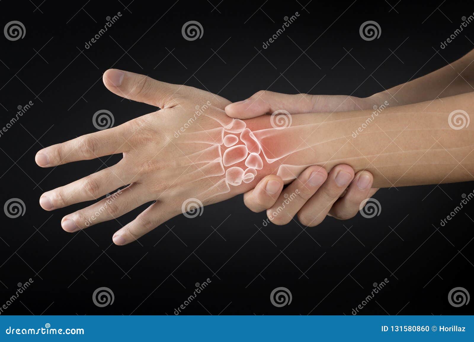 Wrist bones injury stock photo. Image of illness, chronic - 131580860