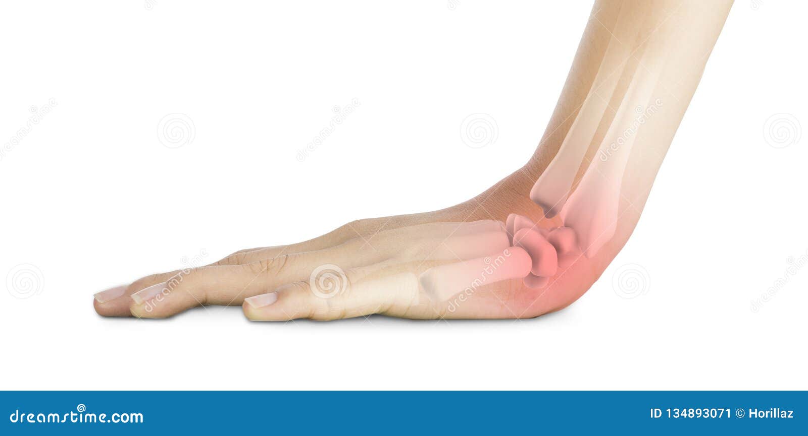 Wrist bones injury stock image. Image of office, diseases - 134893071