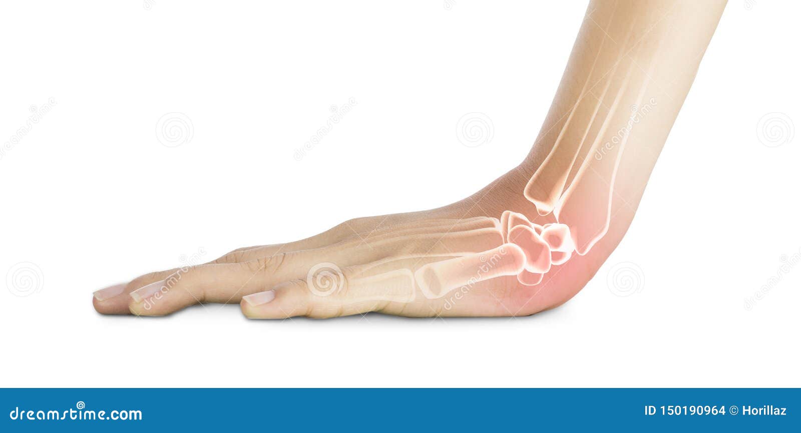 Wrist bones injury stock photo. Image of illness, brittle - 150190964
