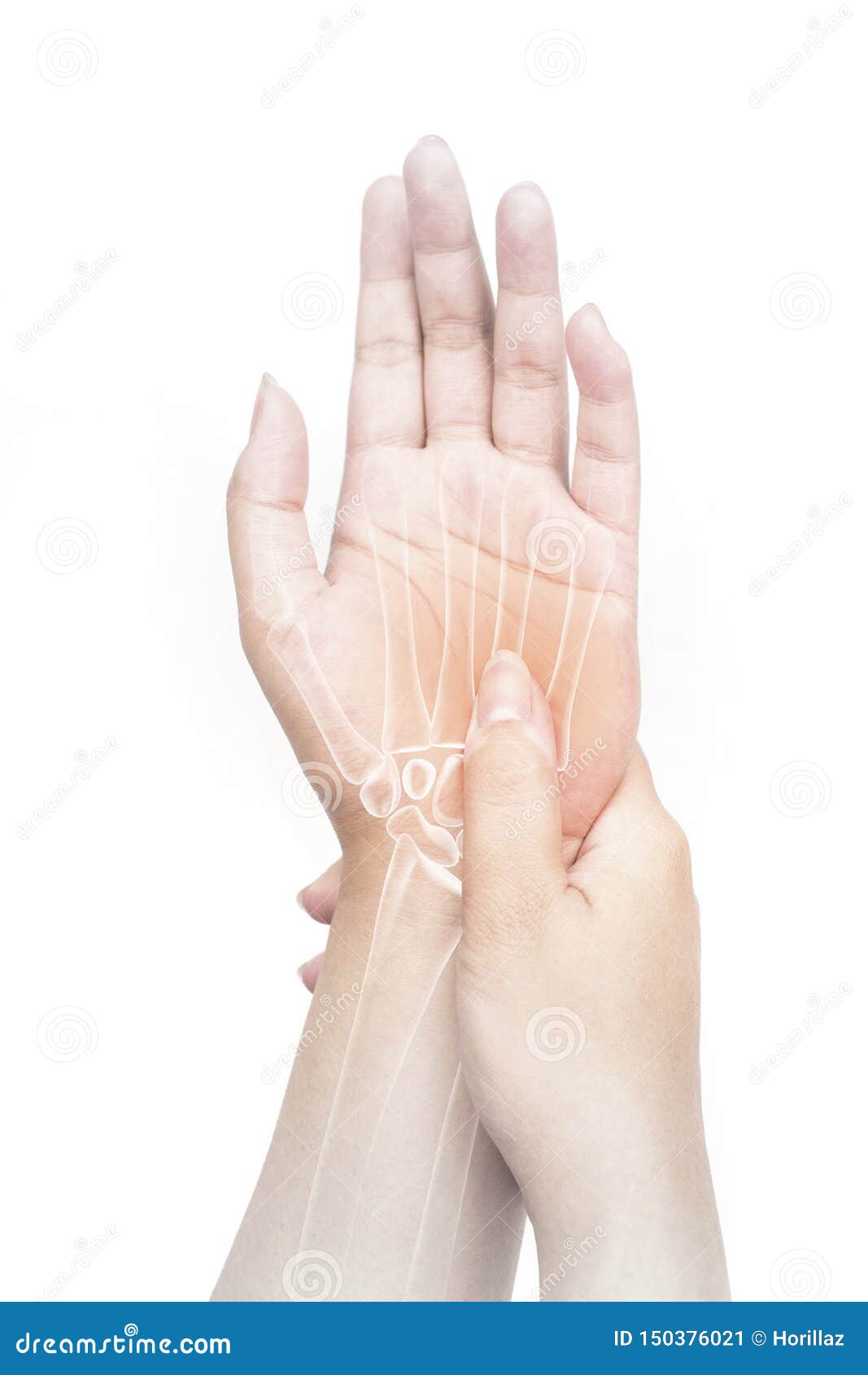 Wrist bones injury stock image. Image of marrow, diseases - 150376021