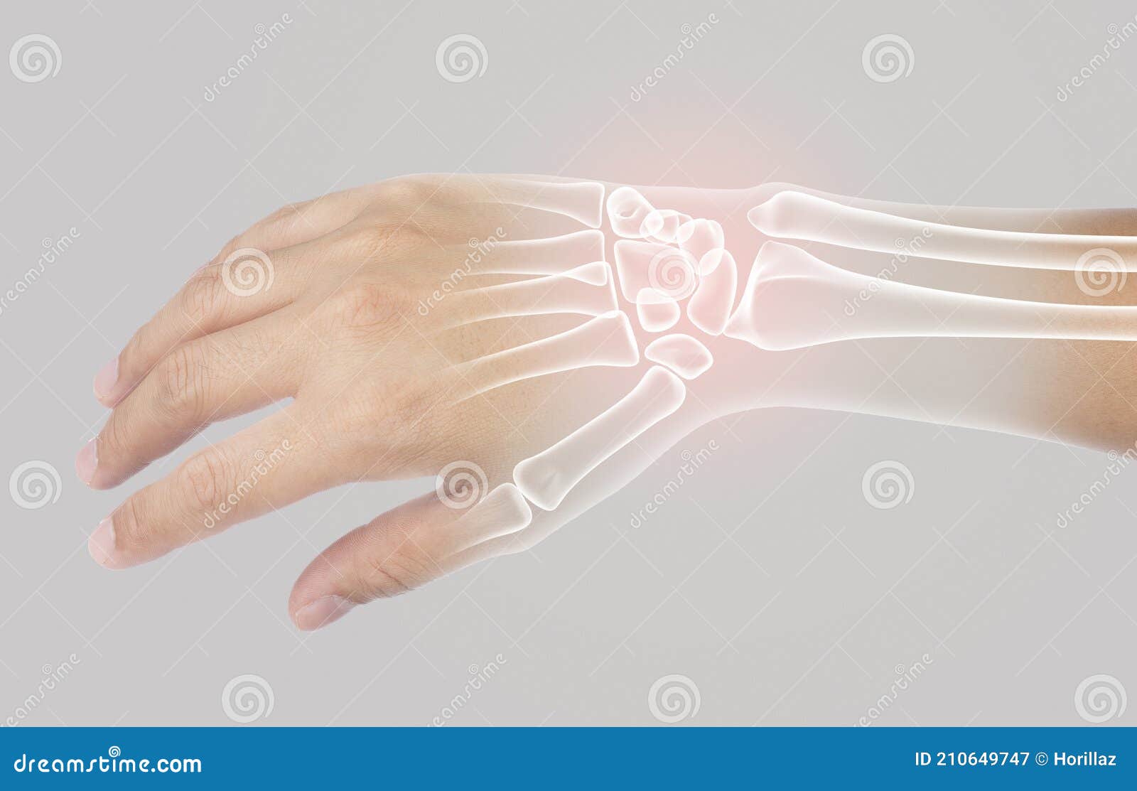 Wrist bones injury stock image. Image of phalanges, osteoporosis ...