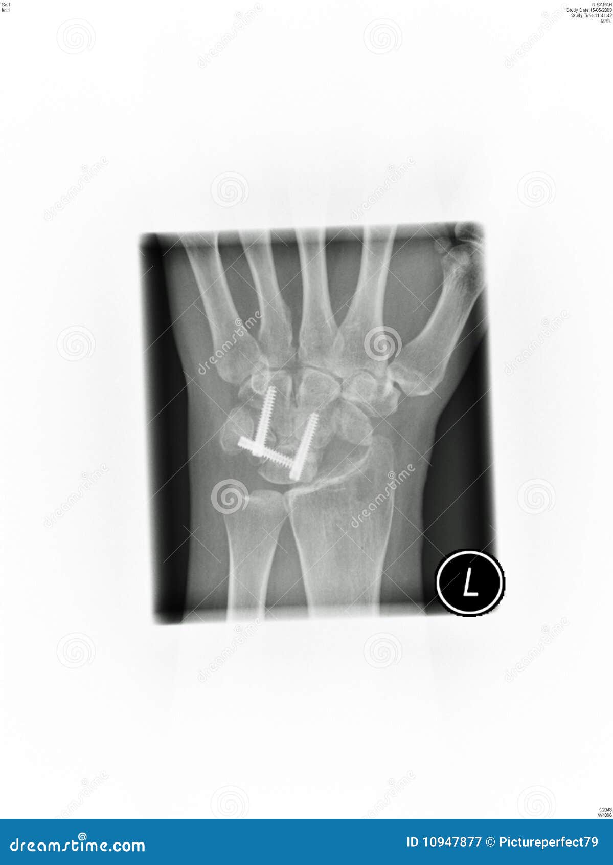 Wrist x-ray stock image. Image of bones, broken, metal - 10947877