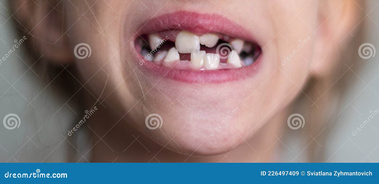 Wrong Bite in a Child. Problem of Teeth in Children Stock Image - Image ...