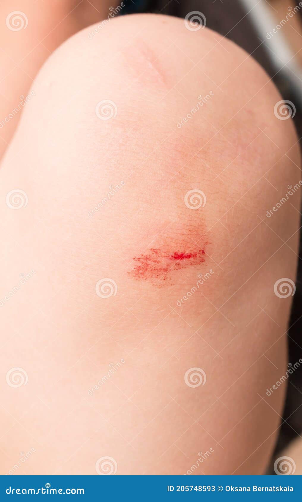 Wunde Auf Dem Knie Des Kindes Stockbild - Bild von farbe, blut: 205748593