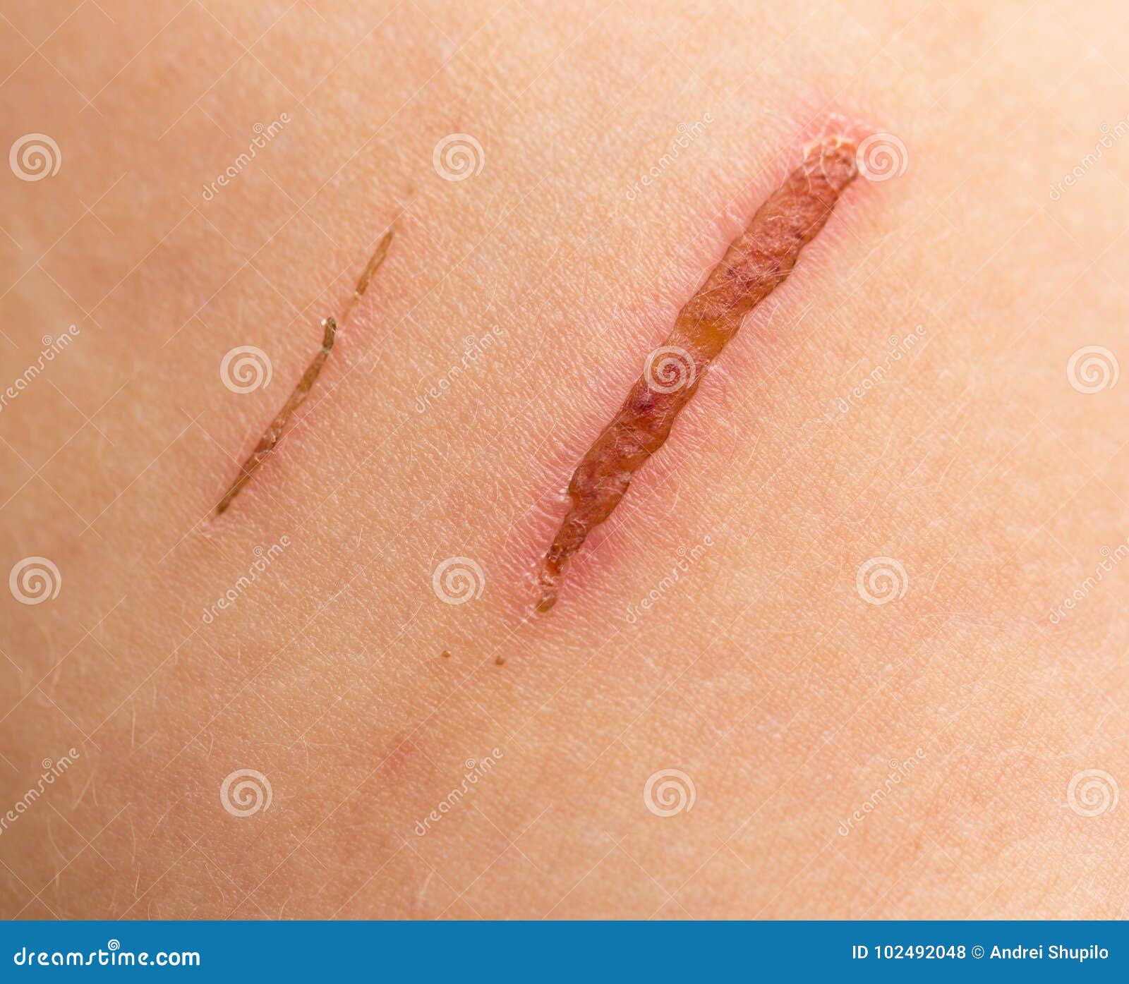 Wunde auf der Haut stockfoto. Bild von kruste, wund - 102492048