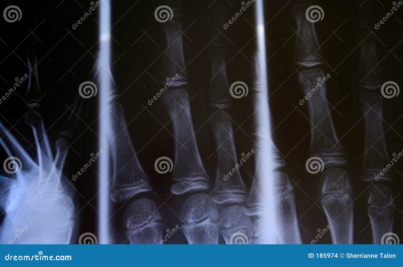 X-ray stock photo. Image of medical, knuckles, healthcare - 185974