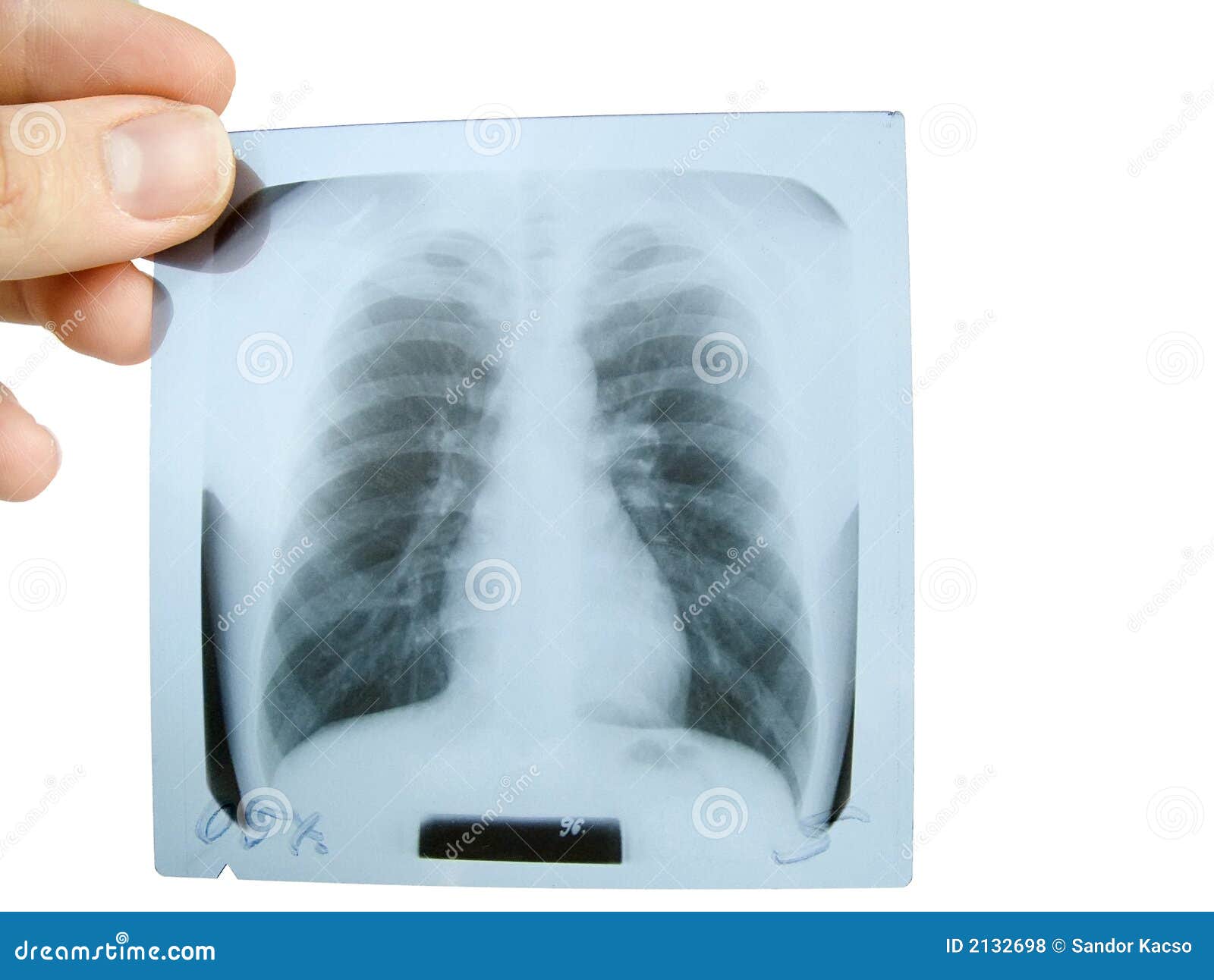 X - ray stock photo. Image of film, computerized, clinic - 2132698