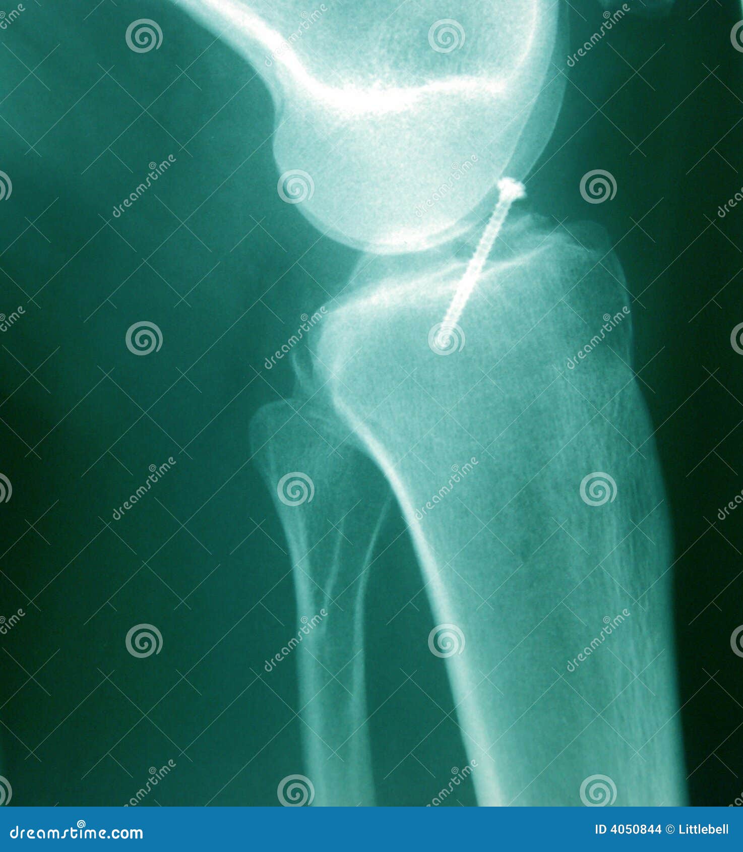 X-ray stock photo. Image of doctor, hurt, broken, bolt - 4050844