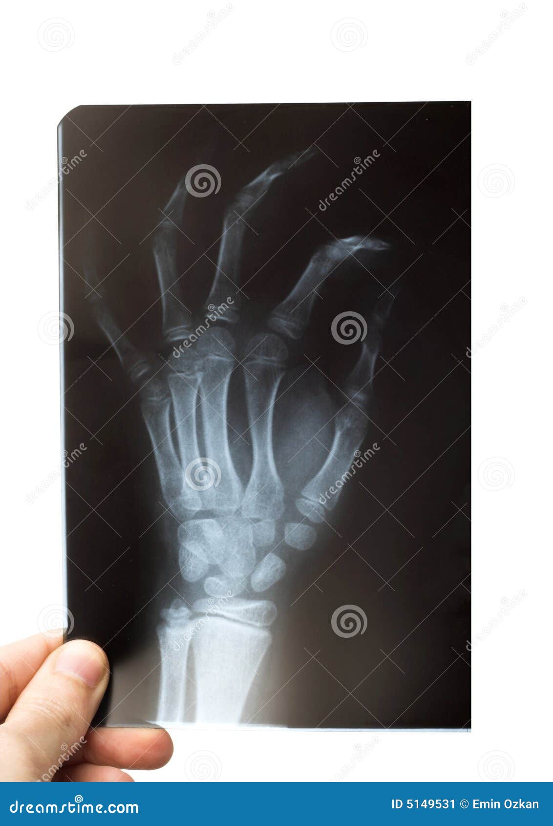 X-ray stock image. Image of looking, injured, healthcare - 5149531