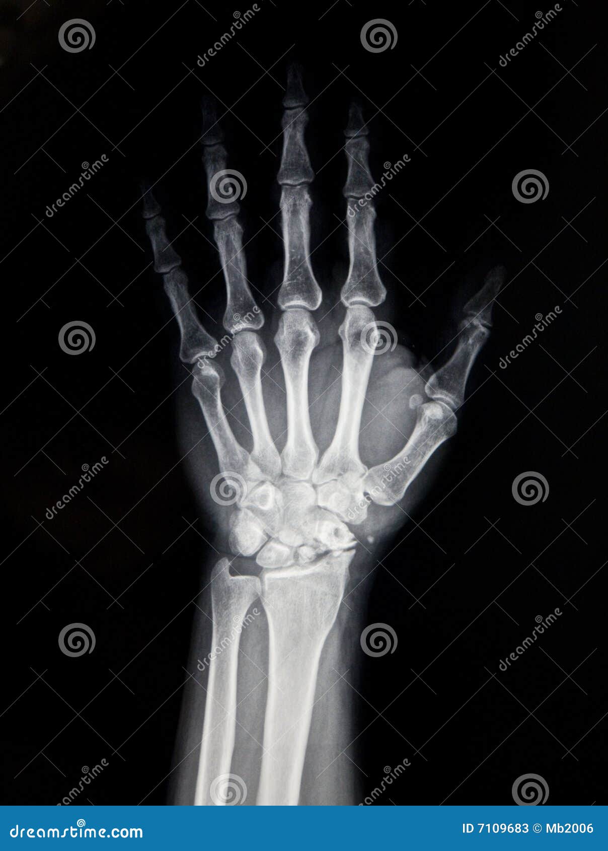 X-ray stock image. Image of radiography, generated, hand - 7109683