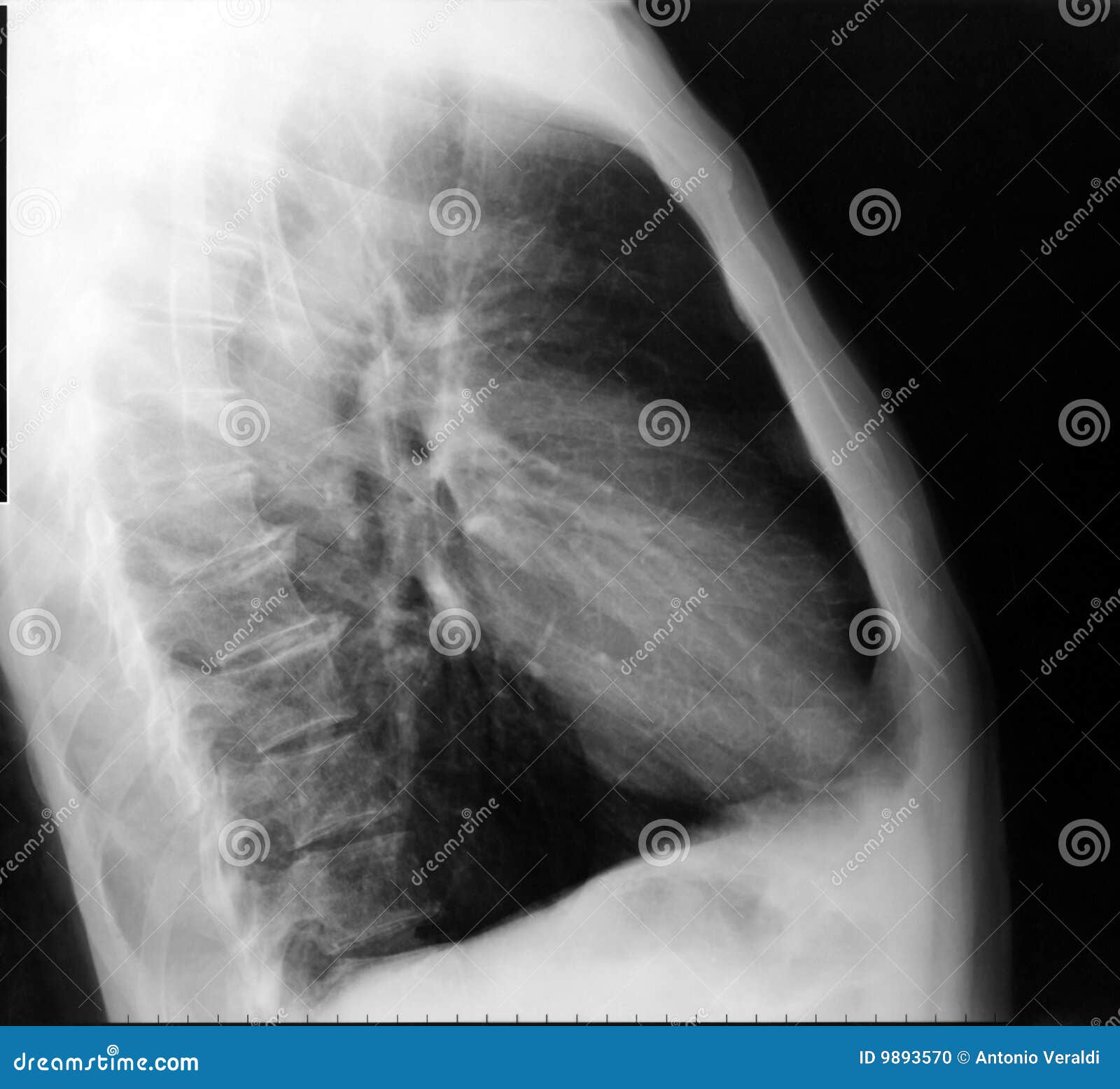 Normal Lung X Ray Lateral