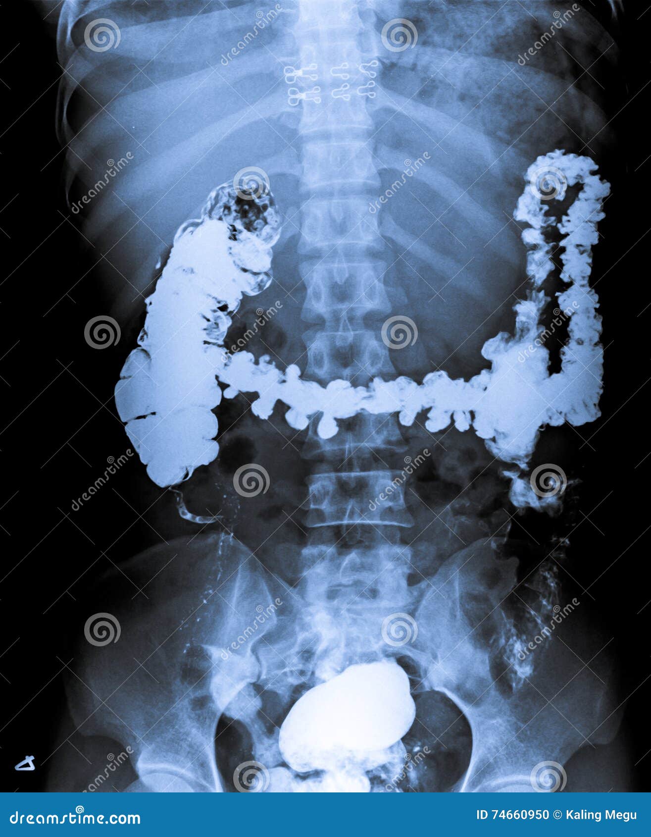 X Ray of Abdomen with Large Intestine. Stock Photo - Image of pelvis ...