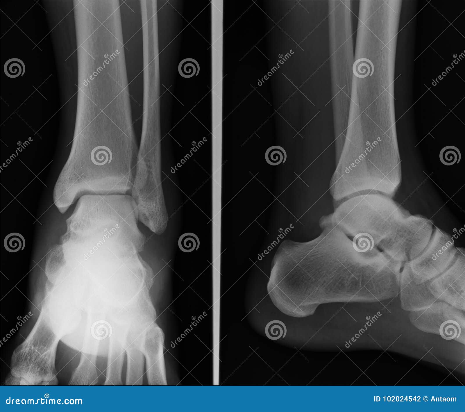 X ray ankle ap lateral stock photo. Image of fibula - 102024542 X ray ankle ap lateral stock photo. Image of fibula - 102024542