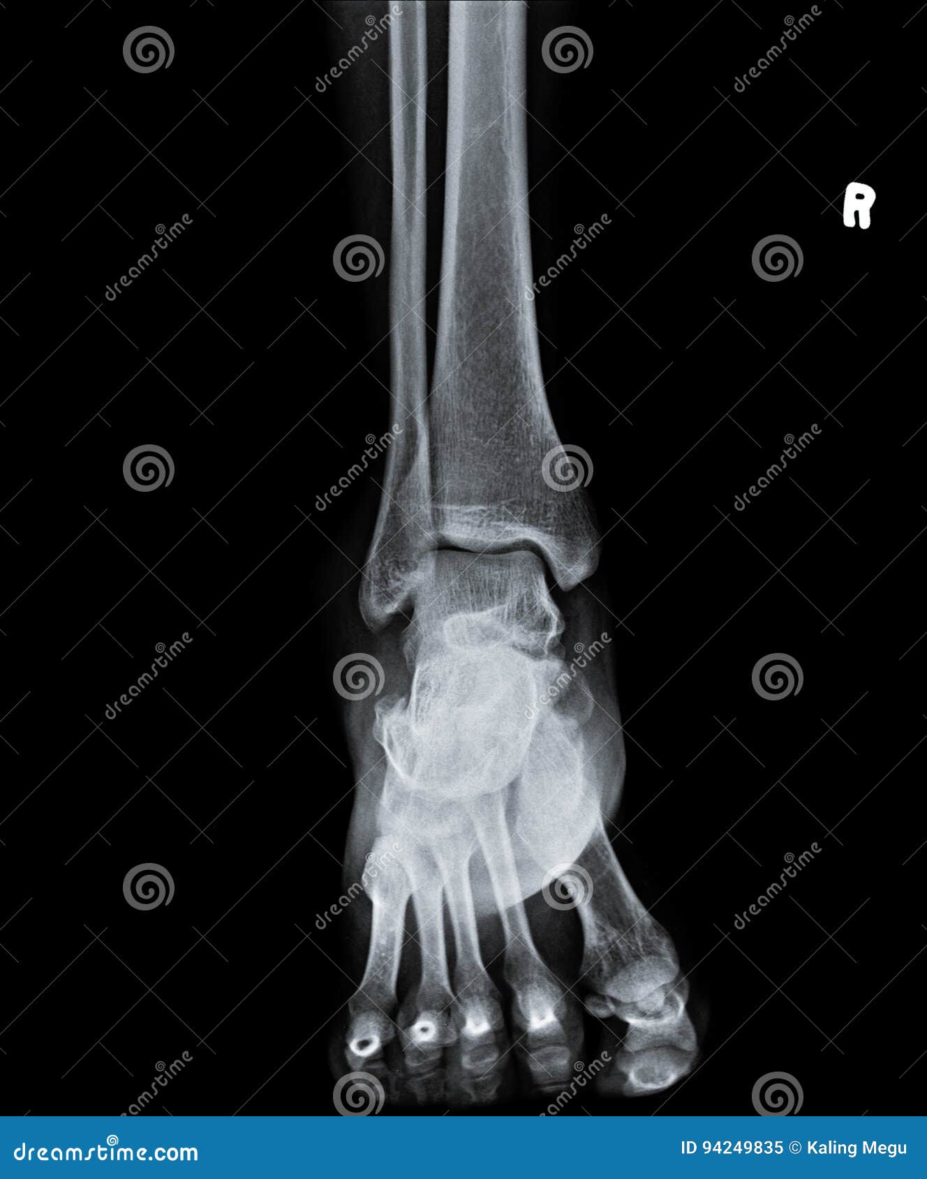 X Ray of Ankle Joint Front View. Stock Image - Image of operation ...