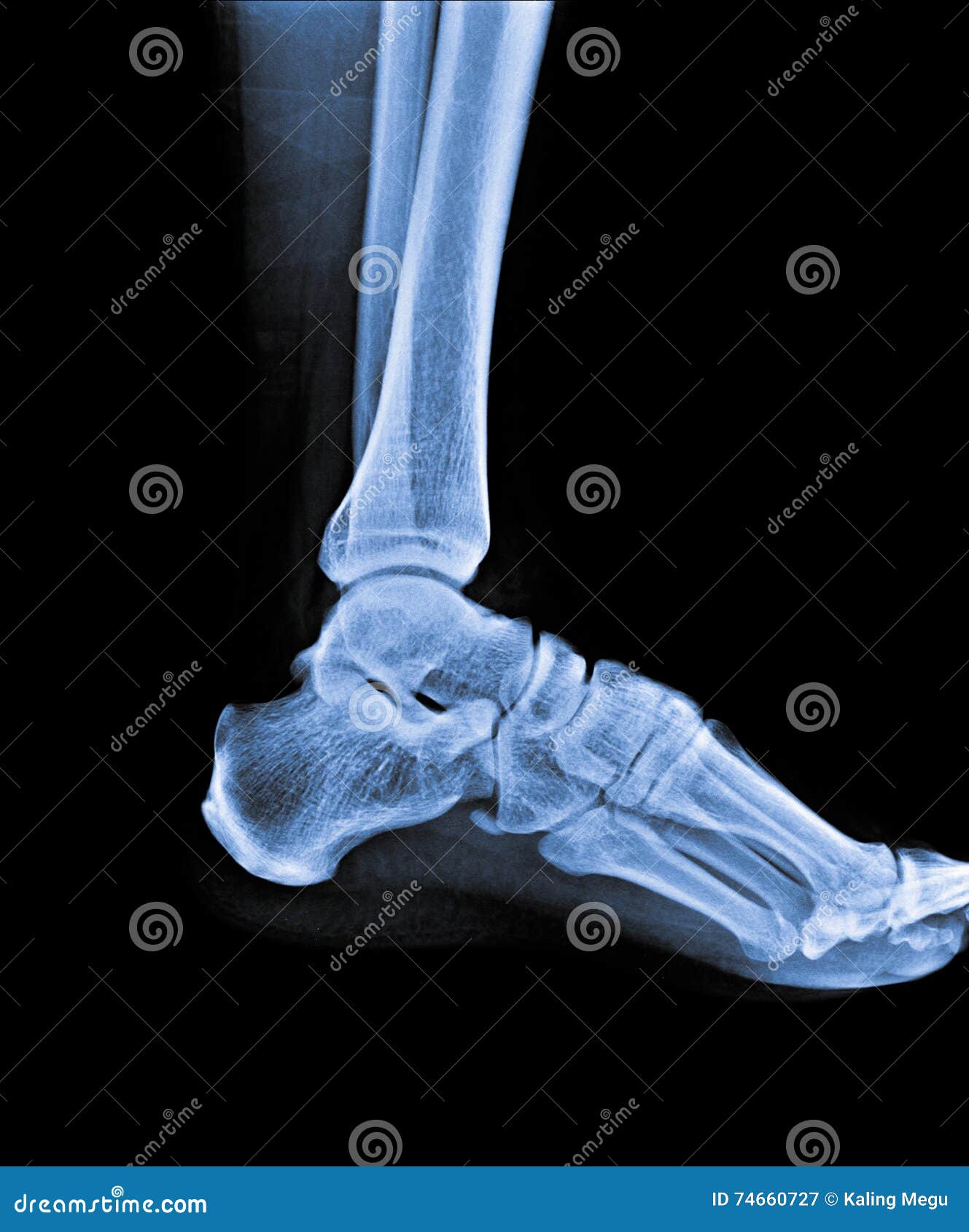 X Ray of Ankle joint stock image. Image of investigation - 74660727