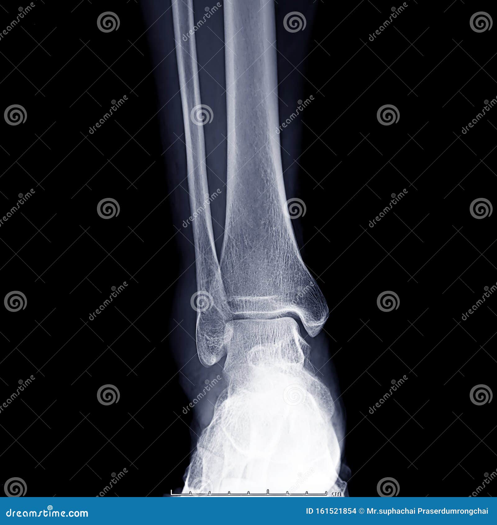 X-ray Ankle Joint or Radiographic Image or X-ray Image of Right Ankle ...