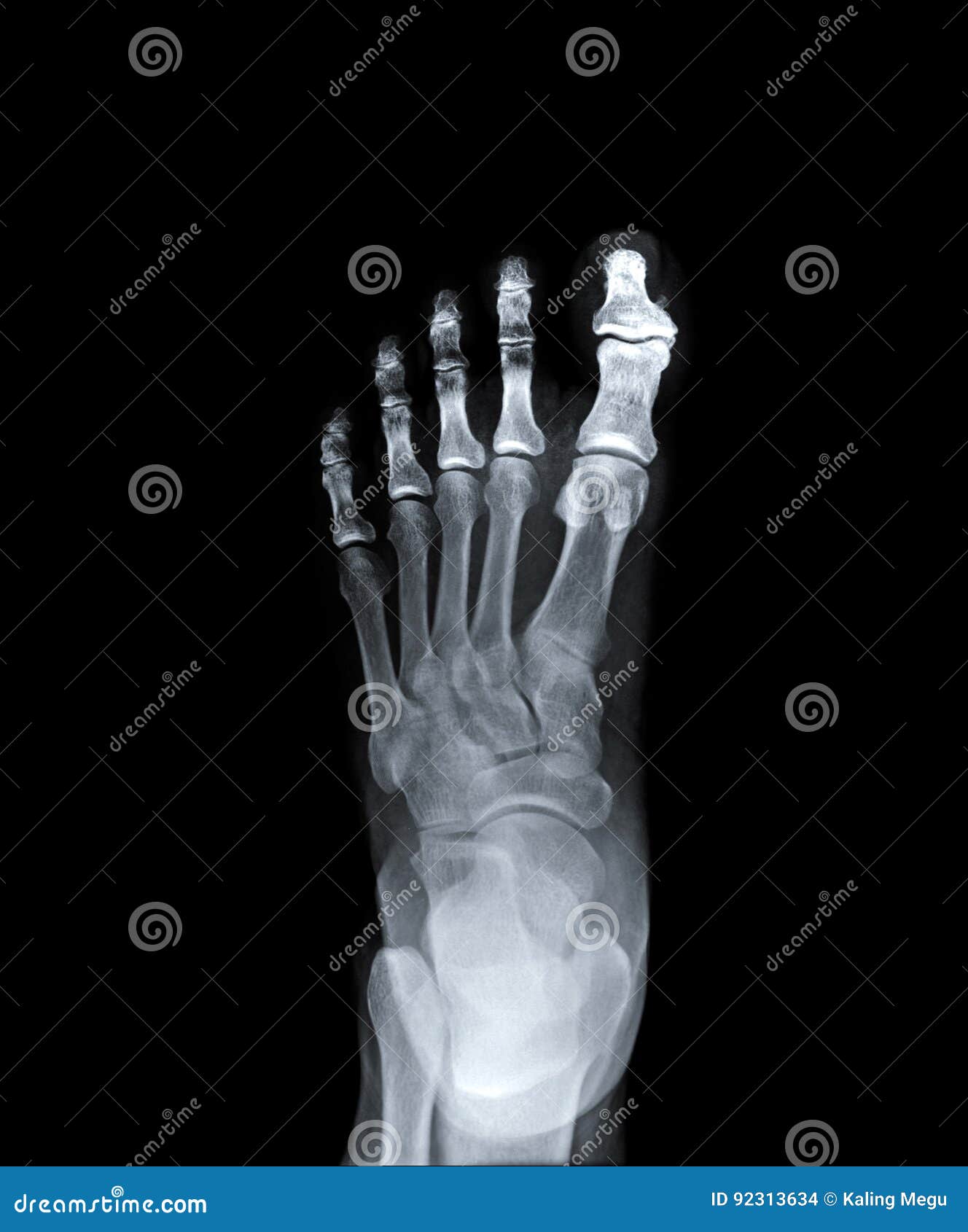 X Ray of Ankle Joint Top View. Stock Photo - Image of front, foot: 92313634