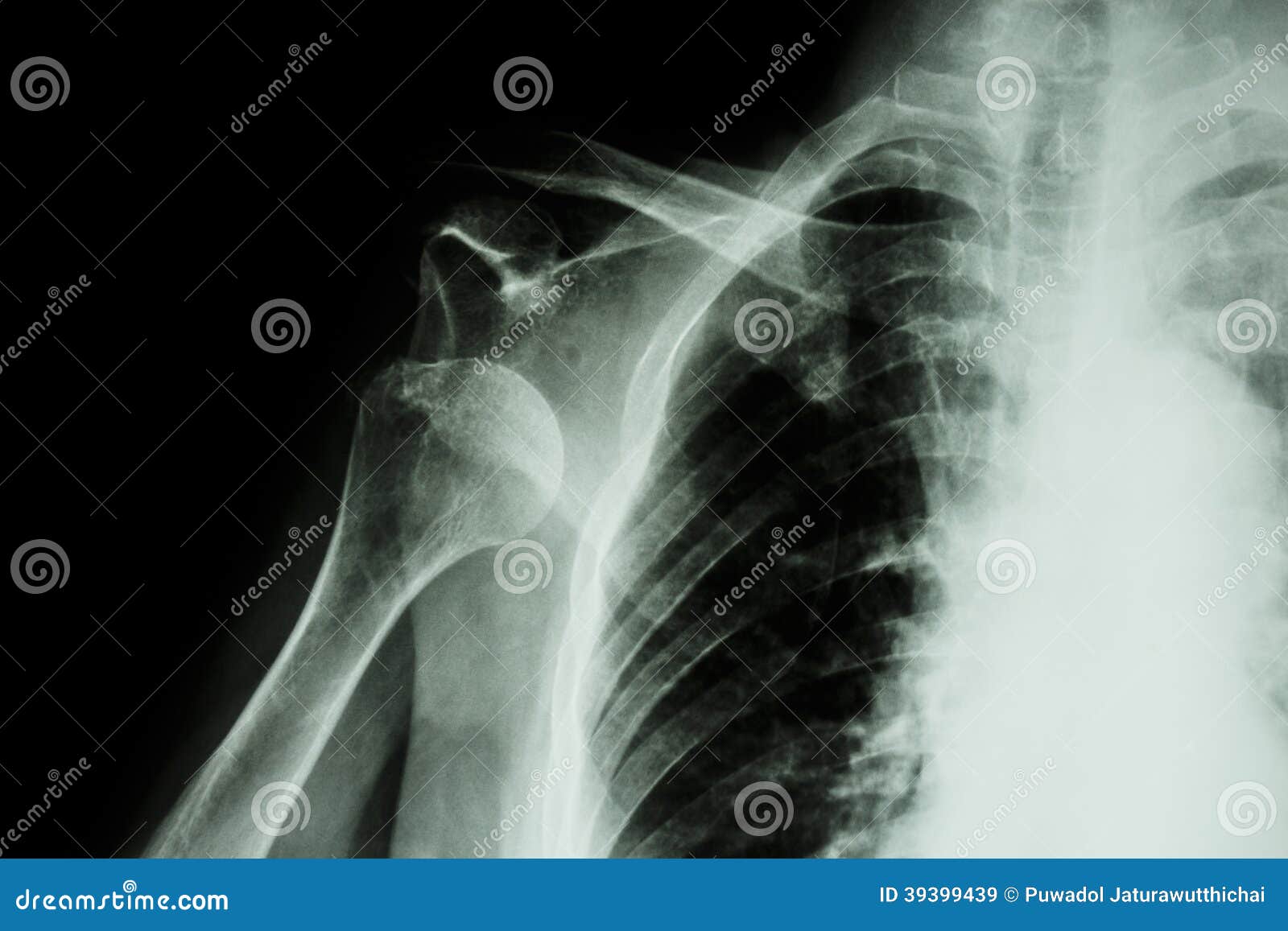 Scapula Anterior View Royalty-Free Stock Image | CartoonDealer.com ...