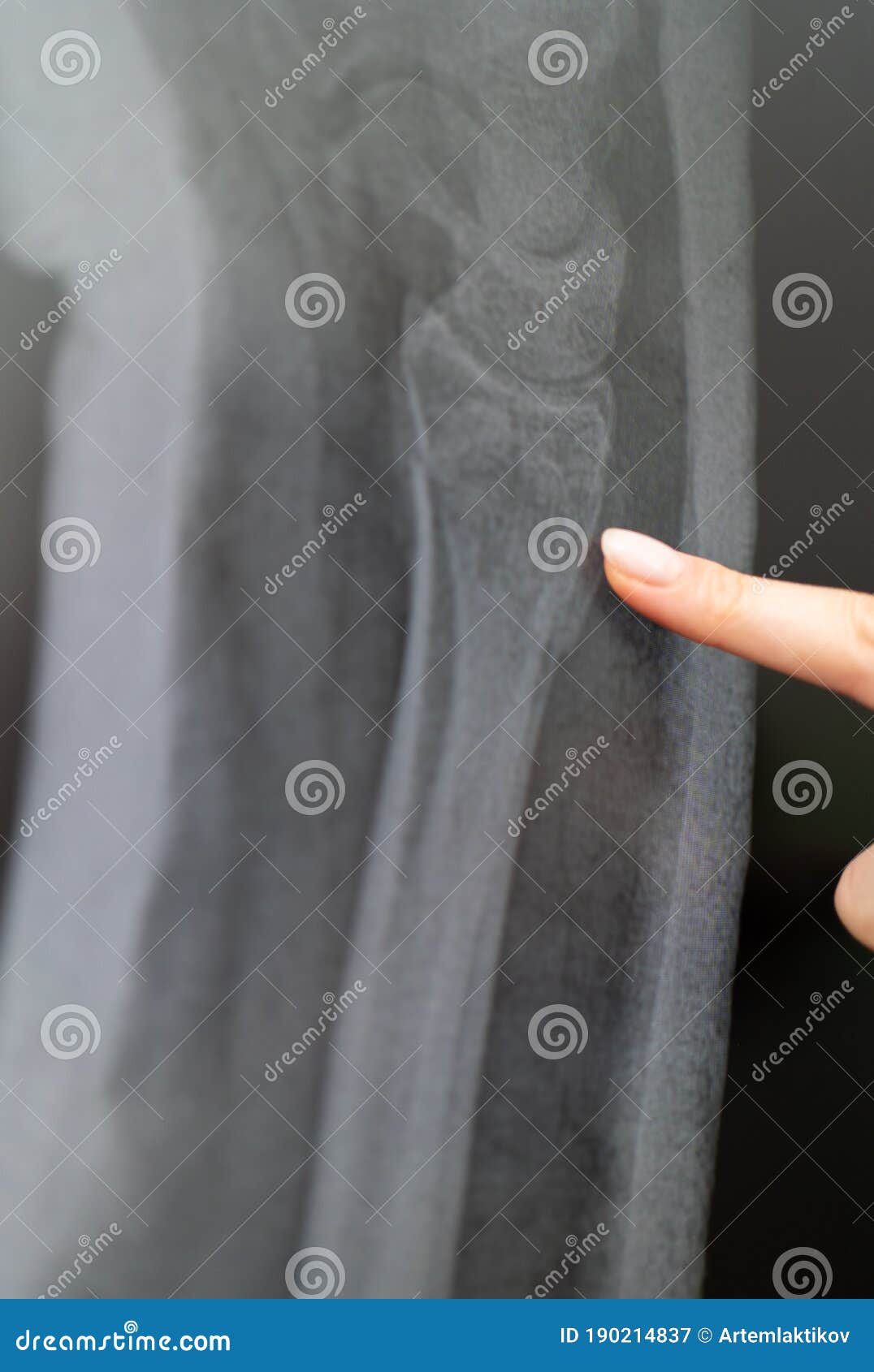 X-ray of the Arm Bone. Radiologist Examines the Crack Stock Image ...