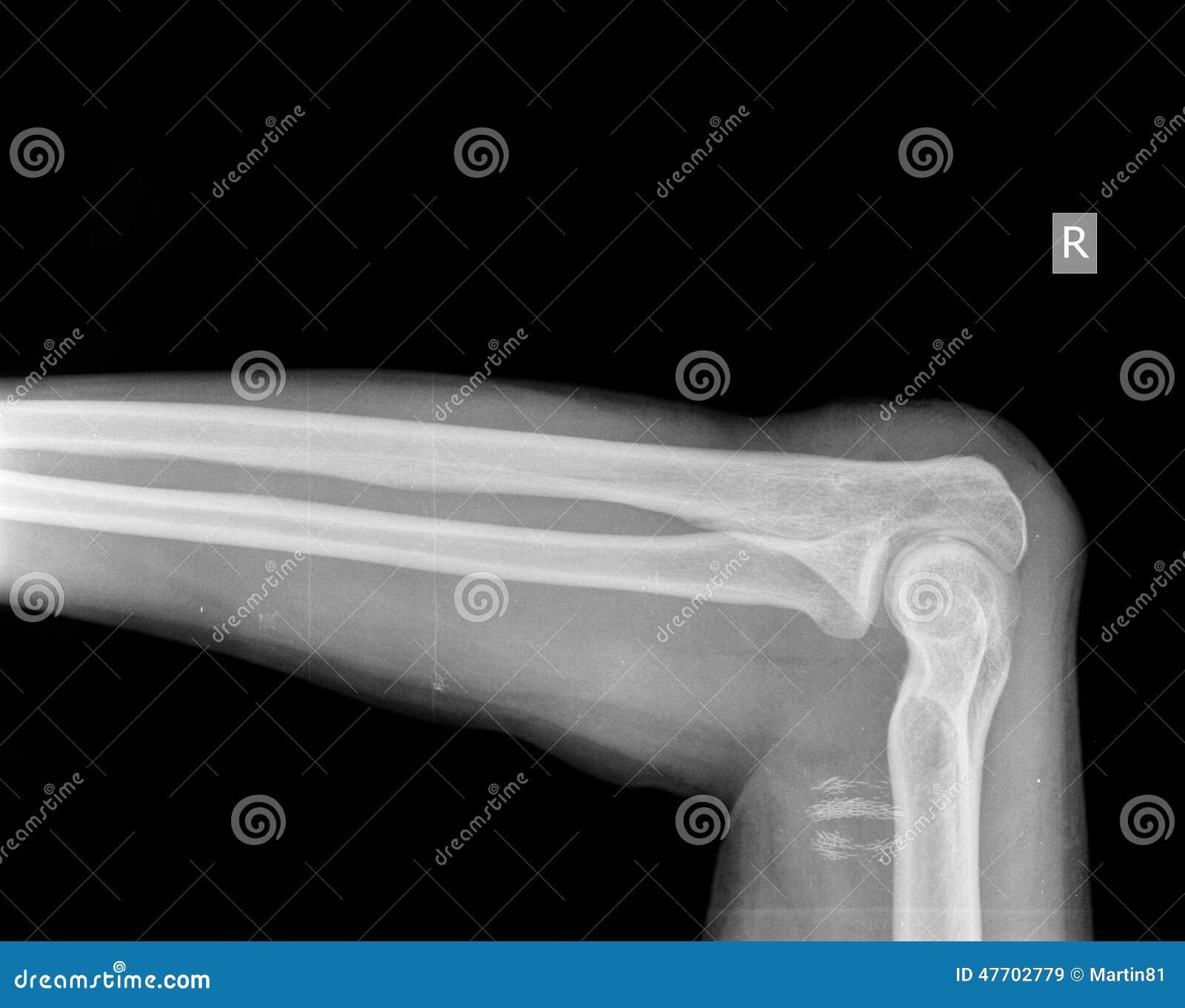 X-ray Of Arm Stock Photo - Image: 47702779