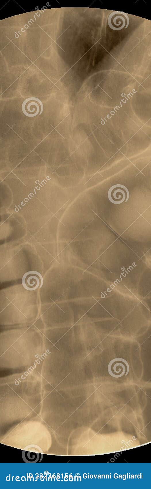 X-ray Barium Enema Examination (lower Gastrointestinal Stock Photo ...