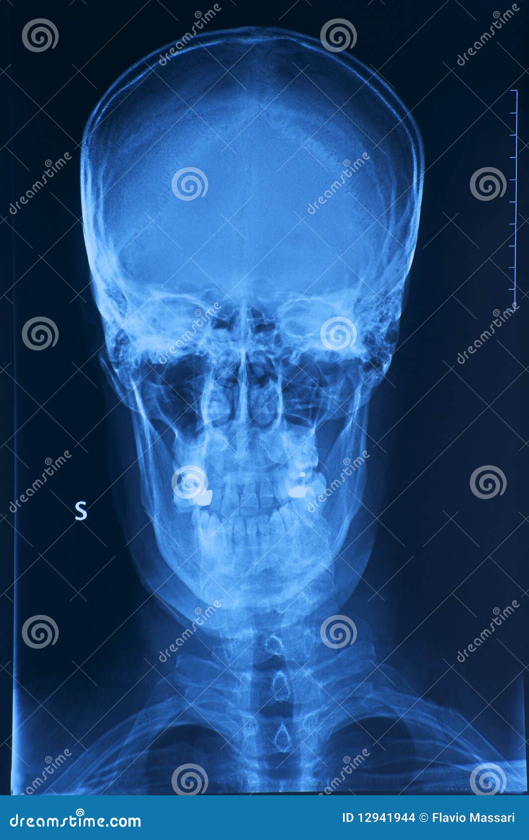 X-ray beeld van de schedel stock foto. Image of controle - 12941944