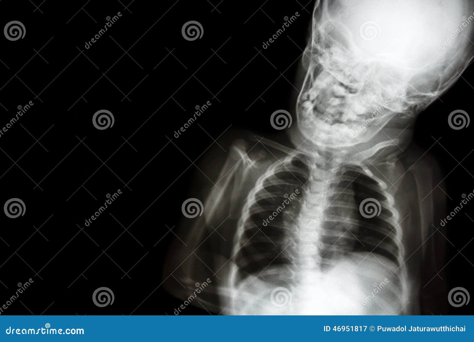 X-ray Body of Child and Blank Area at Left Side Stock Image - Image of ...